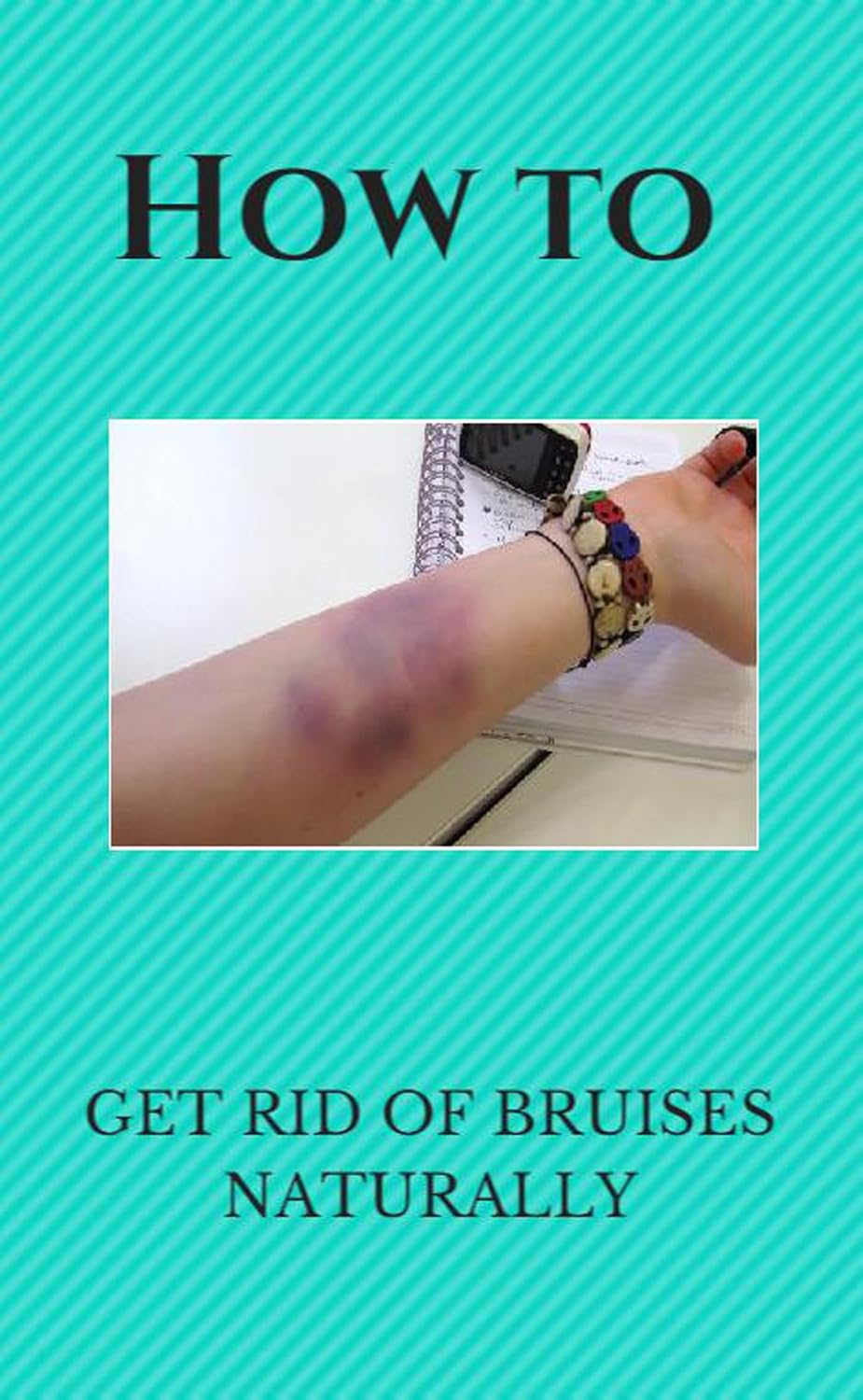 Amazon.com: How To Get Rid Of Bruises Naturally eBook : Thailler ...