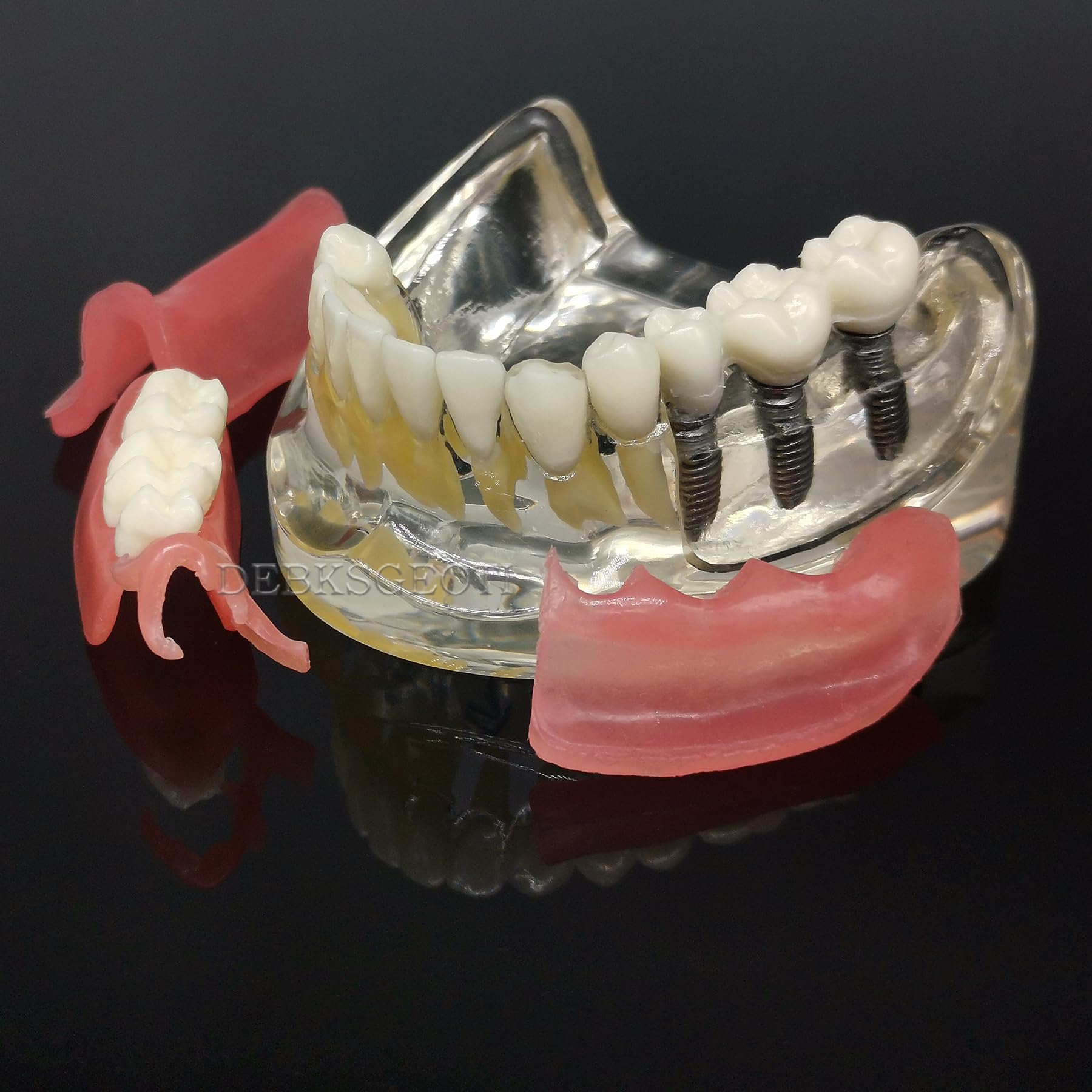 Snapklik.com : Dental Implant Typodont Restoration Teeth Model M6006 ...
