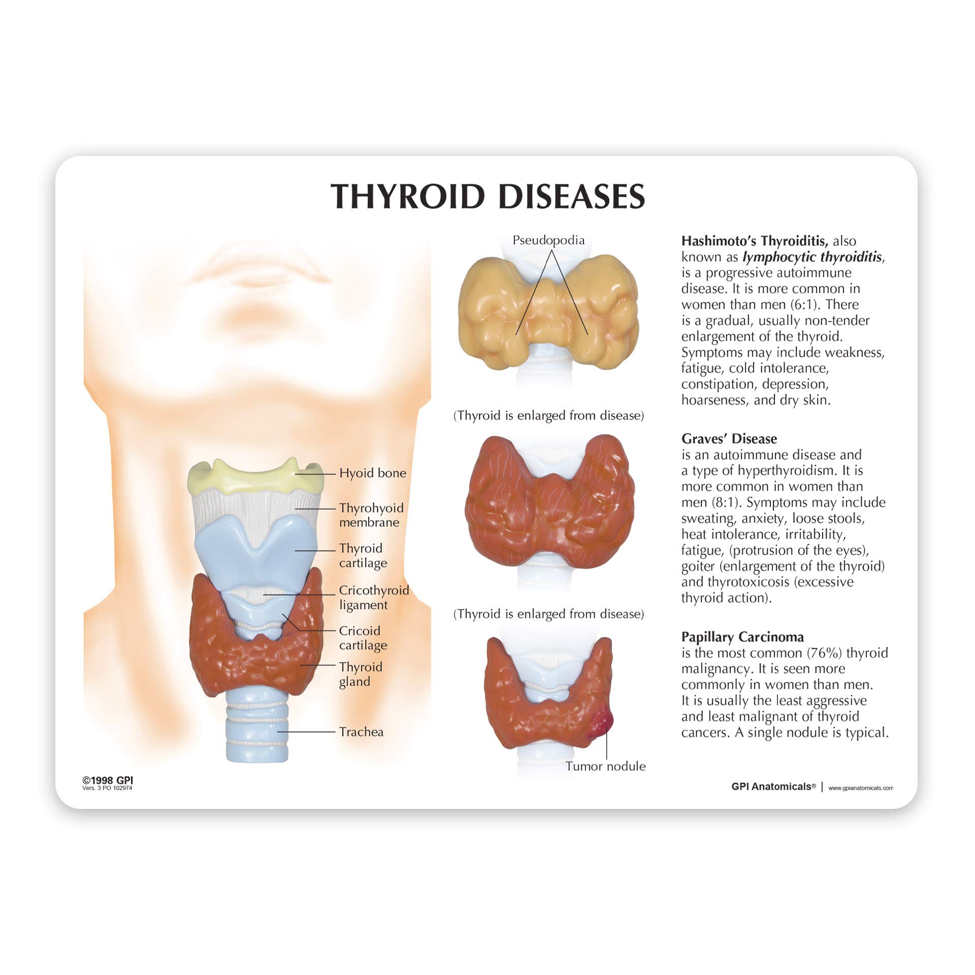 Thyroid Model Set | Human Body Anatomy Replica of Thyroid w/Diseases ...