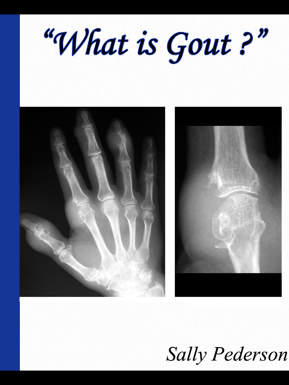 What Is Gout The Ultimate Guide To Mastering And Conquering ...