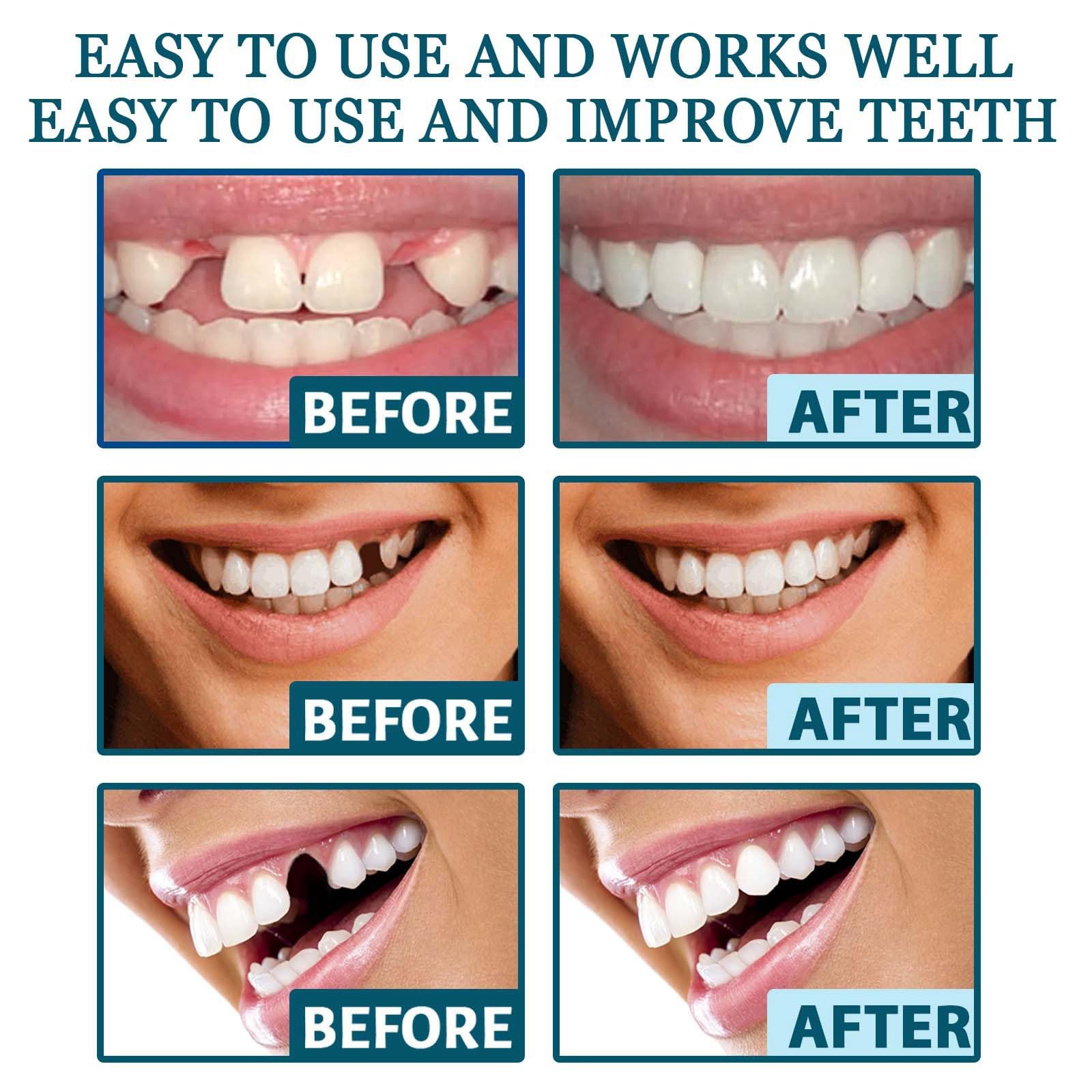 Silicone Reline Denture Set,Denture Silicone Reline Kit,Silicone ...