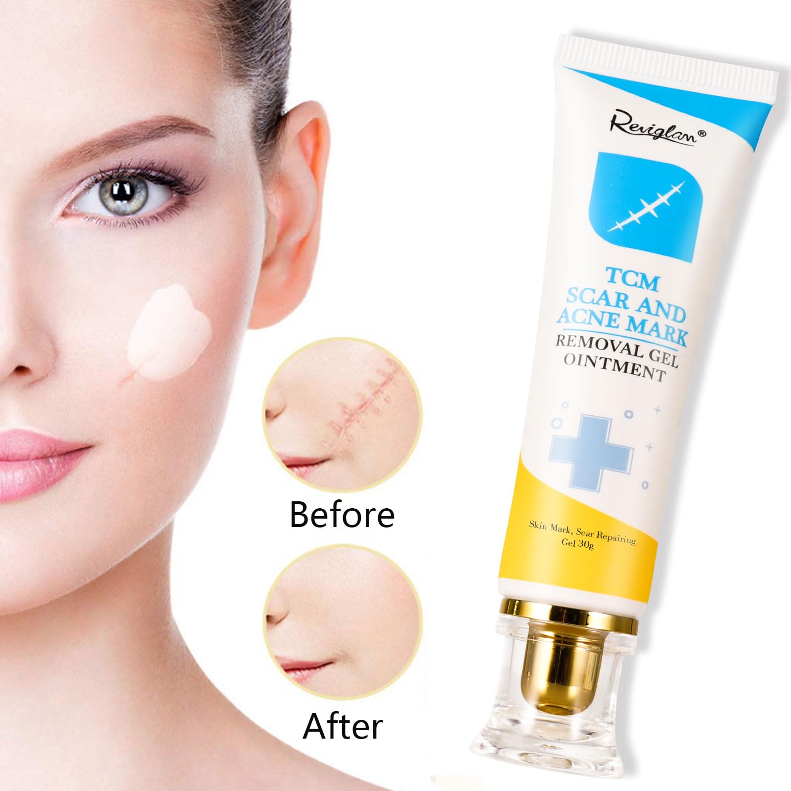 Snapklik.com : Scar And Acne Marks Removal Ointment Gel, Scar Removal ...
