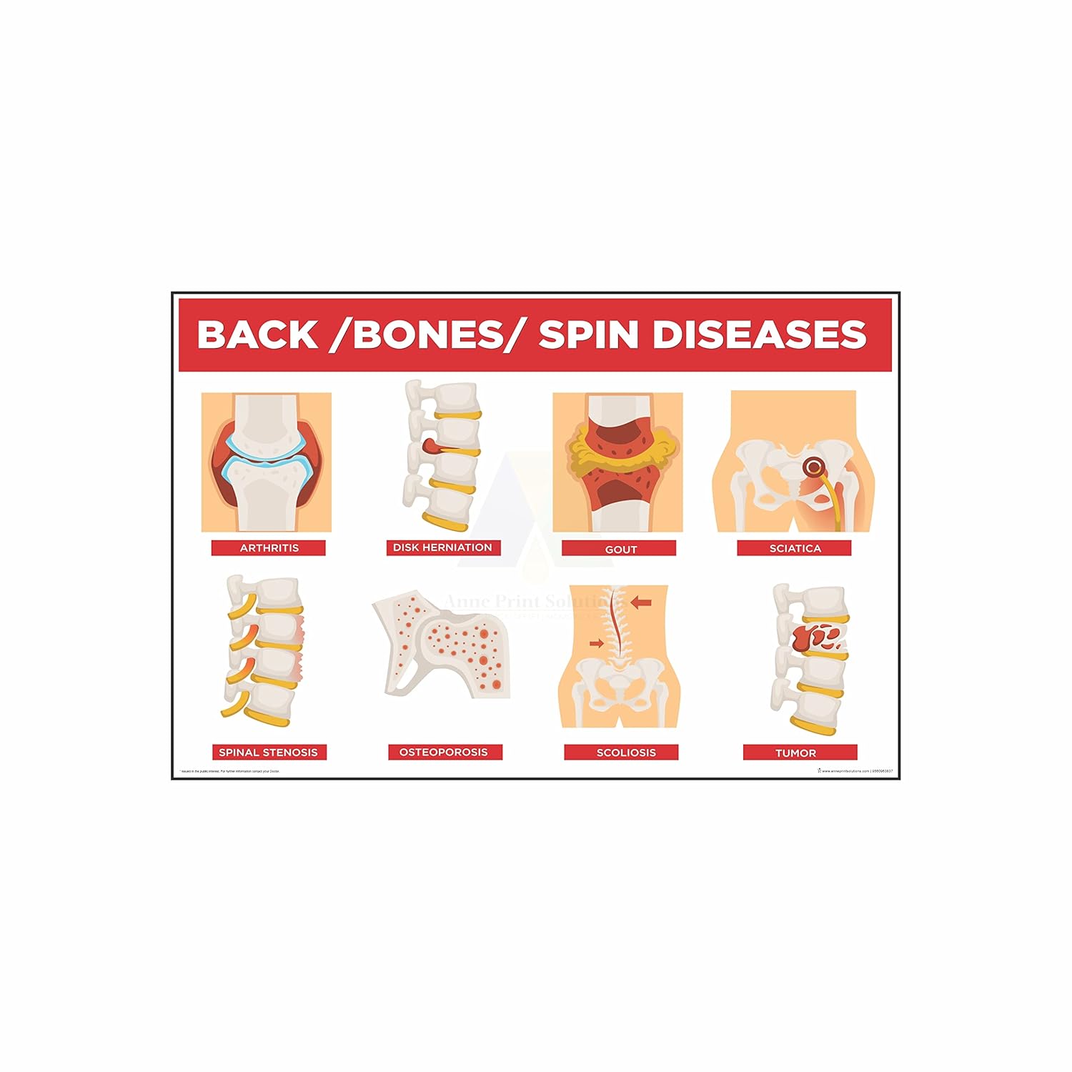 Anne Print Solutions® Back bones skin disease Posters For Hospital ...