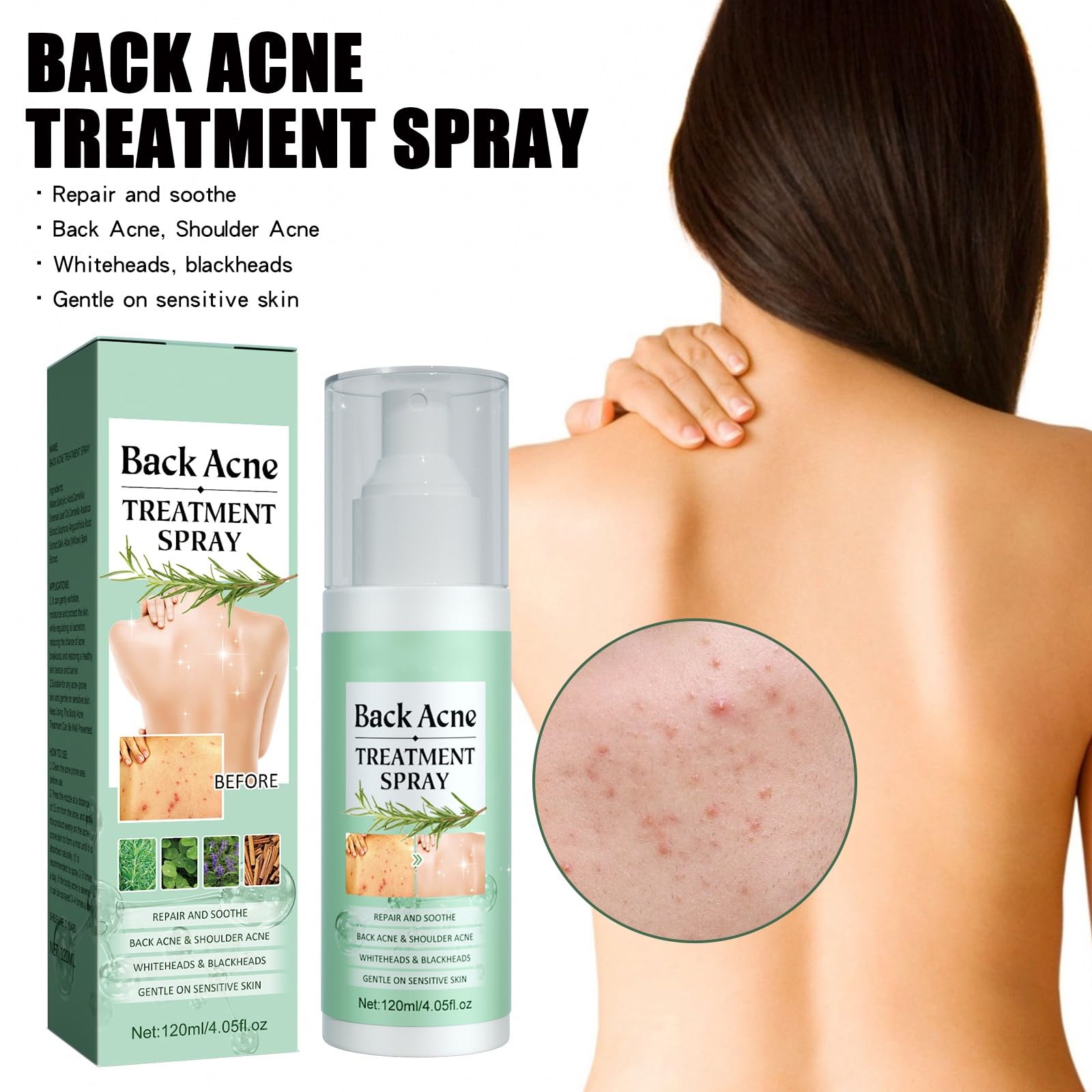 Snapklik.com : Back Acne Spray, Back Acne Treatment, 2% Salicylic Acid ...