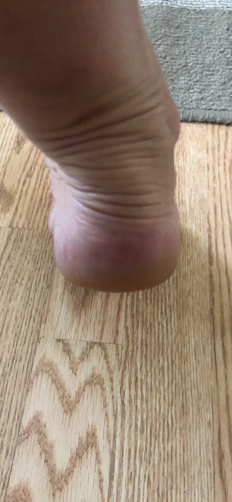 Footlogix Cracked Heel Formula Mousse – Intensive Foot Foam for Rough ...