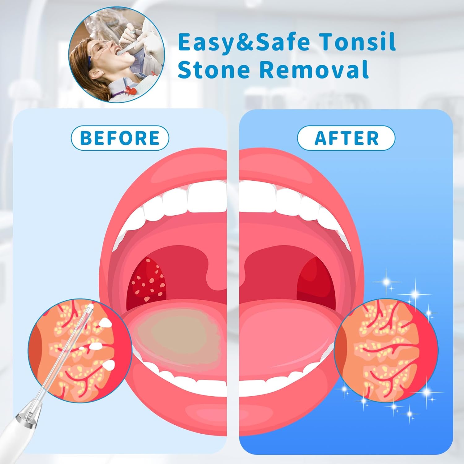 10 Pack Tonsil Stone Remover,Tonsil Stone Remover Australia | Ubuy