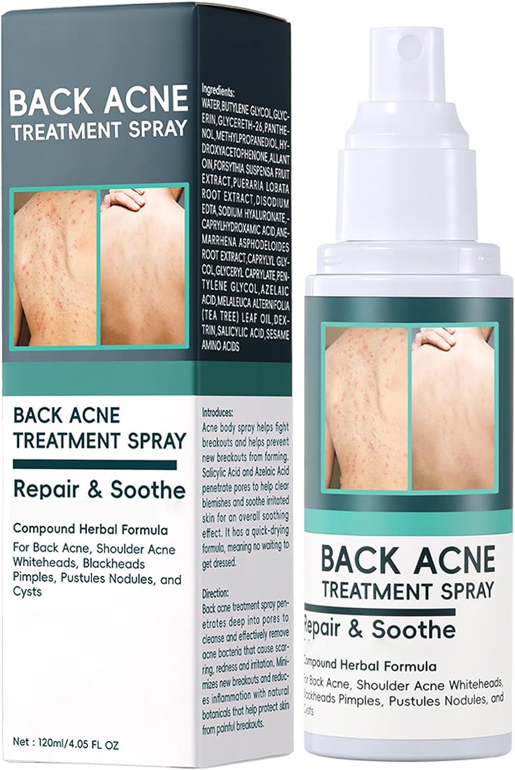 Back & Body Acne Spray,Back Acne Treatment Spray for Women,Soothing ...