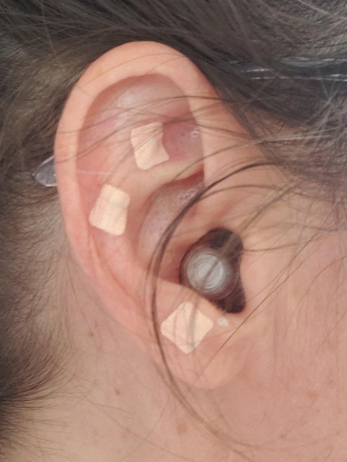 Amazon.com: Headache & Migraines Ear Seed Kit- 120 Ear Seeds, Stainless ...