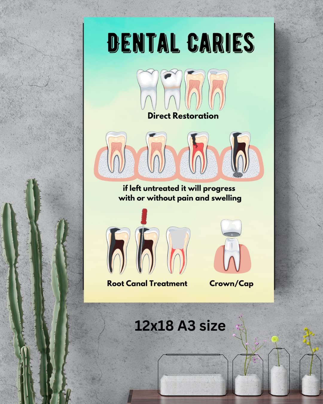Dental Caries poster for dental clinic without frame : Amazon.in: Home ...