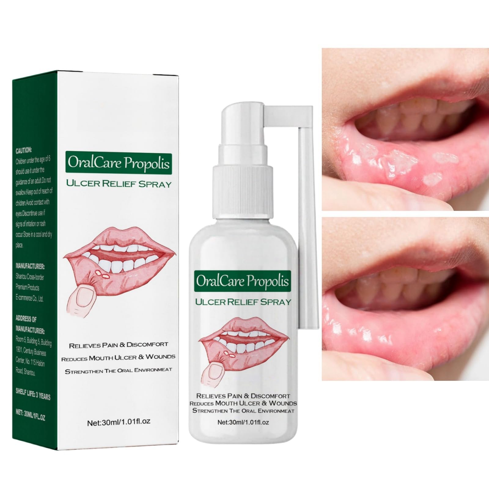 Mouth Ulcer Treatment Spray,Mouth Ulcer Spray,Canker Sore Treatment for ...