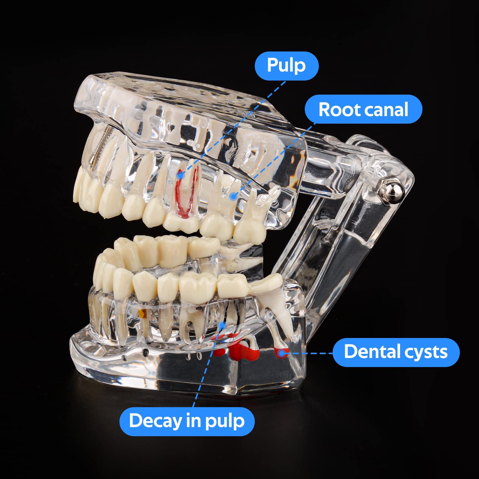 Snapklik.com : Ultrassist Transparent Disease Teeth Model