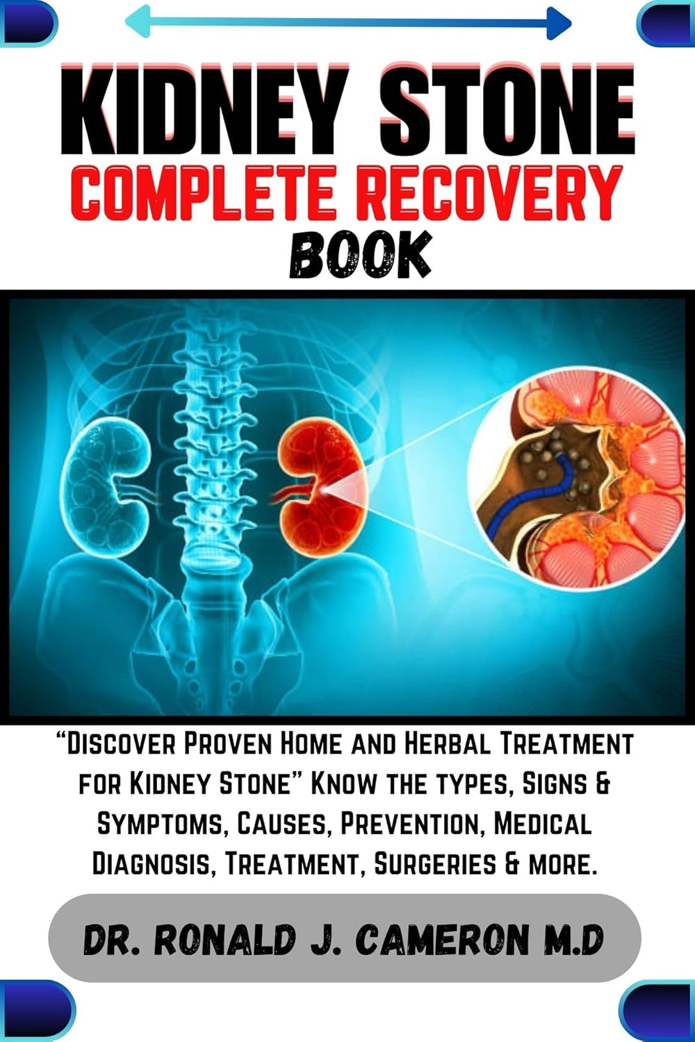 Amazon.com: KIDNEY STONE COMPLETE RECOVERY BOOK: “Discover Proven Home ...