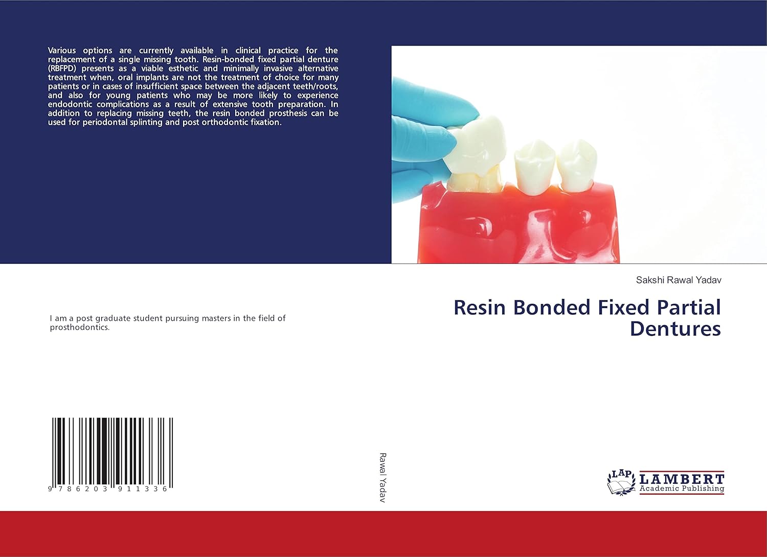 Resin Bonded Fixed Partial Dentures: Rawal Yadav, Sakshi: 9786203911336 ...