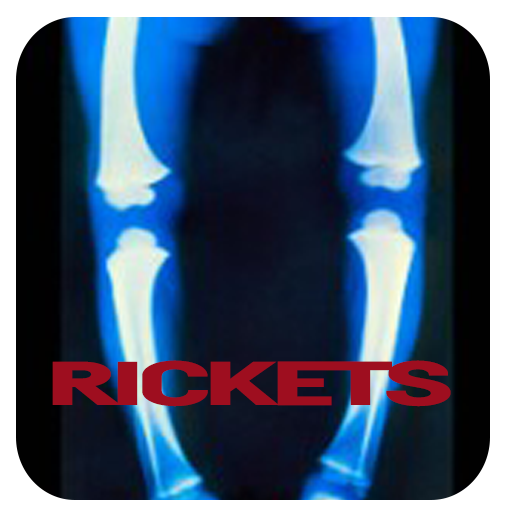 Rickets Disease