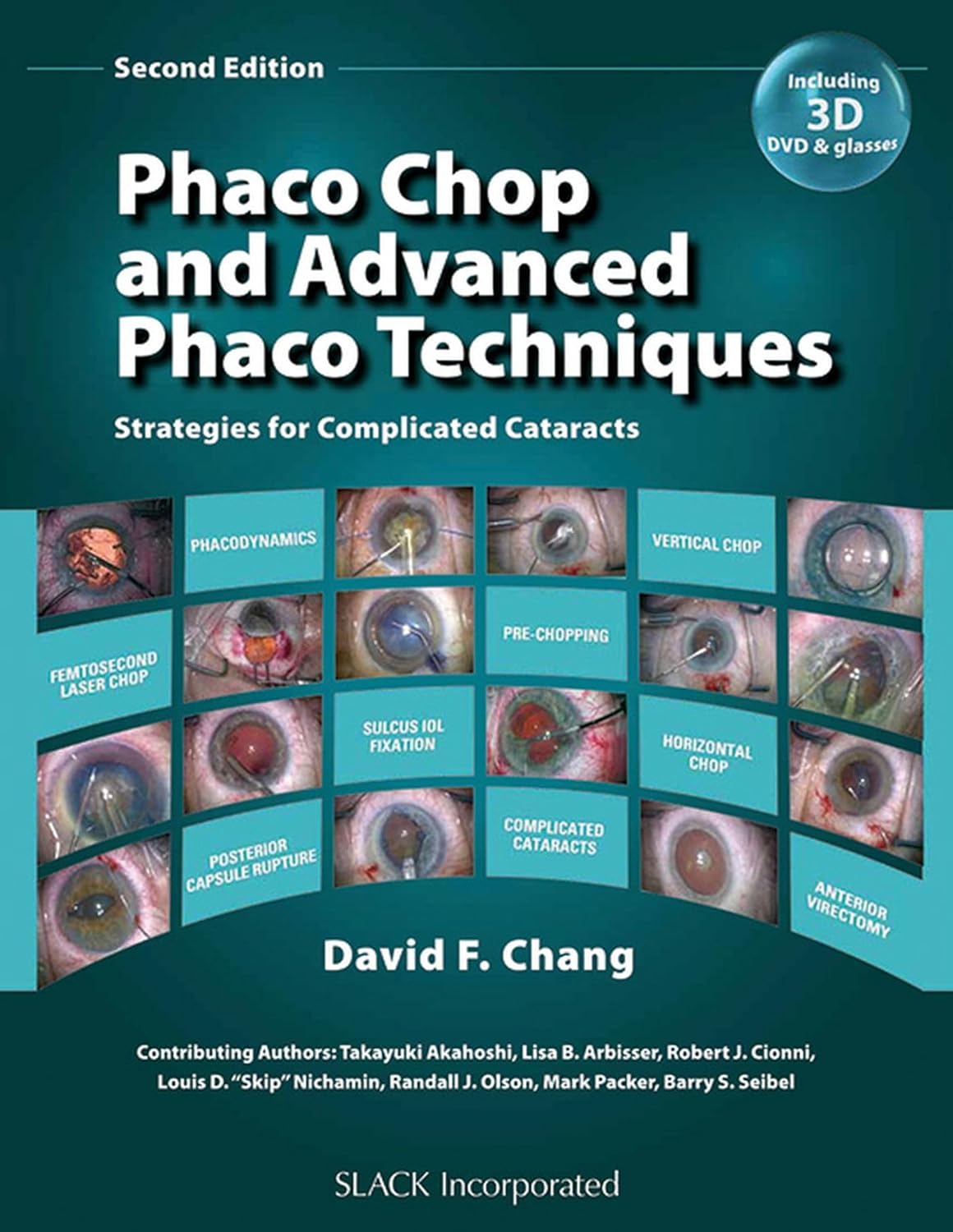 Phaco Chop and Advanced Phaco Techniques: Strategies for Complicated ...