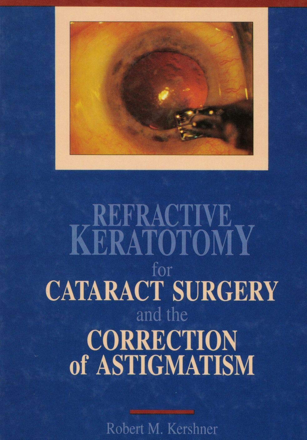 Refractive Keratotomy for Cataract Surgery and Astigmatism ...