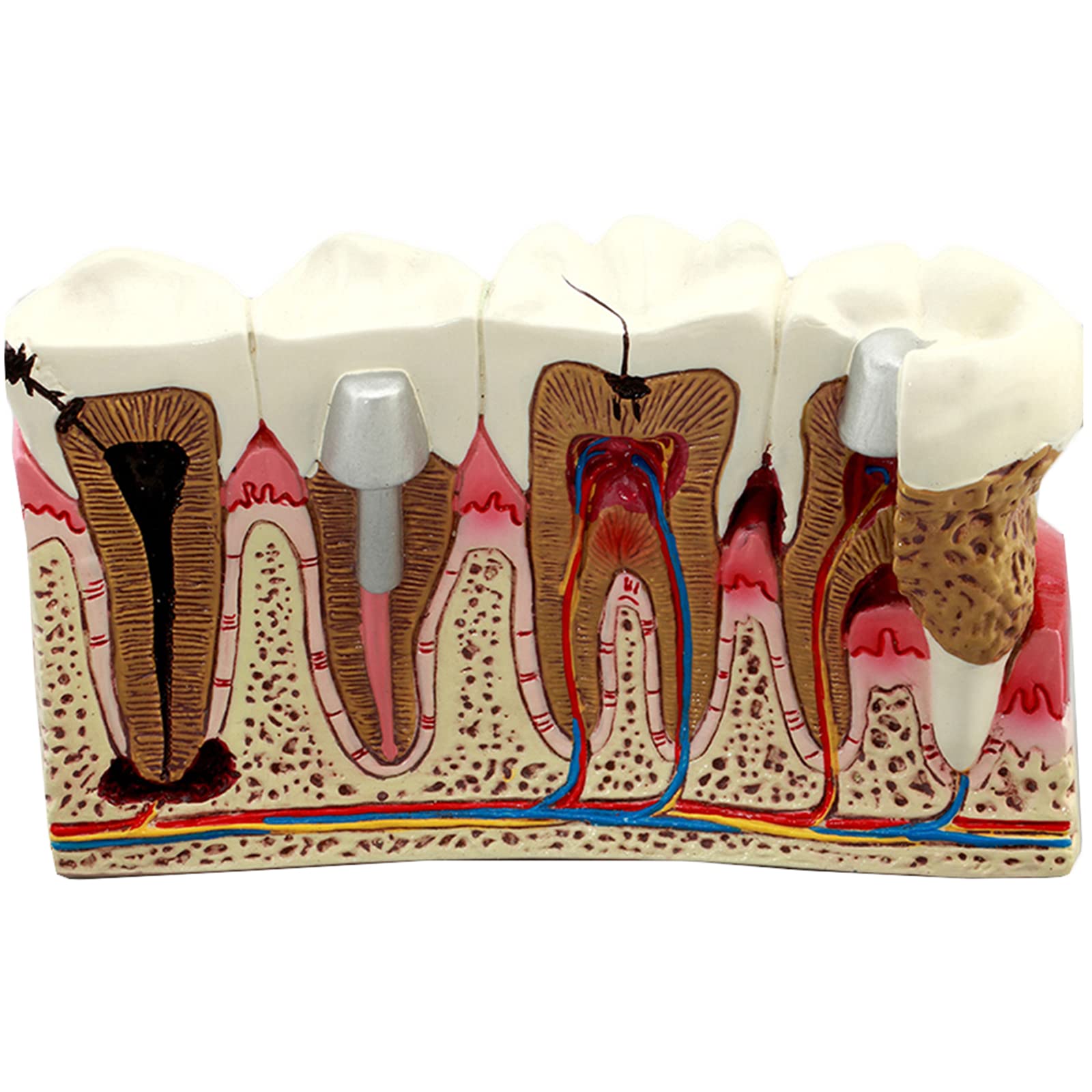 Buy K99 Caries Oral Teaching Use Pathology Teeth Model Dental Caries ...