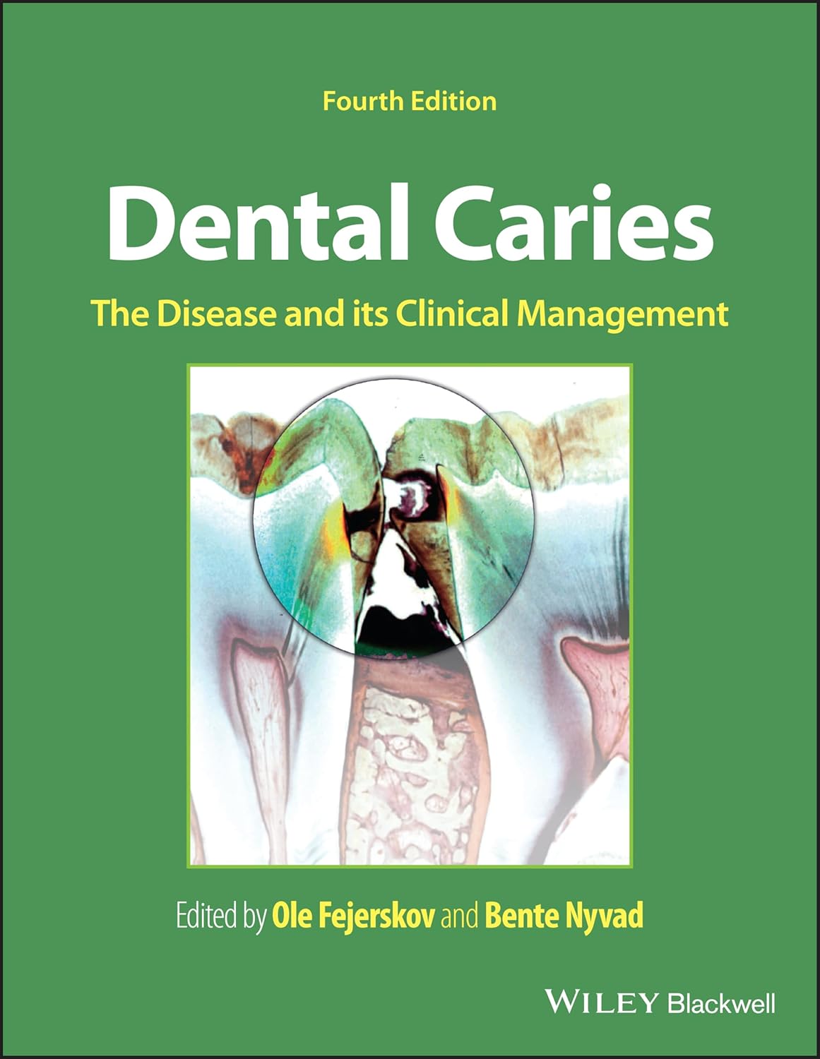 Dental Caries: The Disease and Its Clinical Management | Amazon.com.br