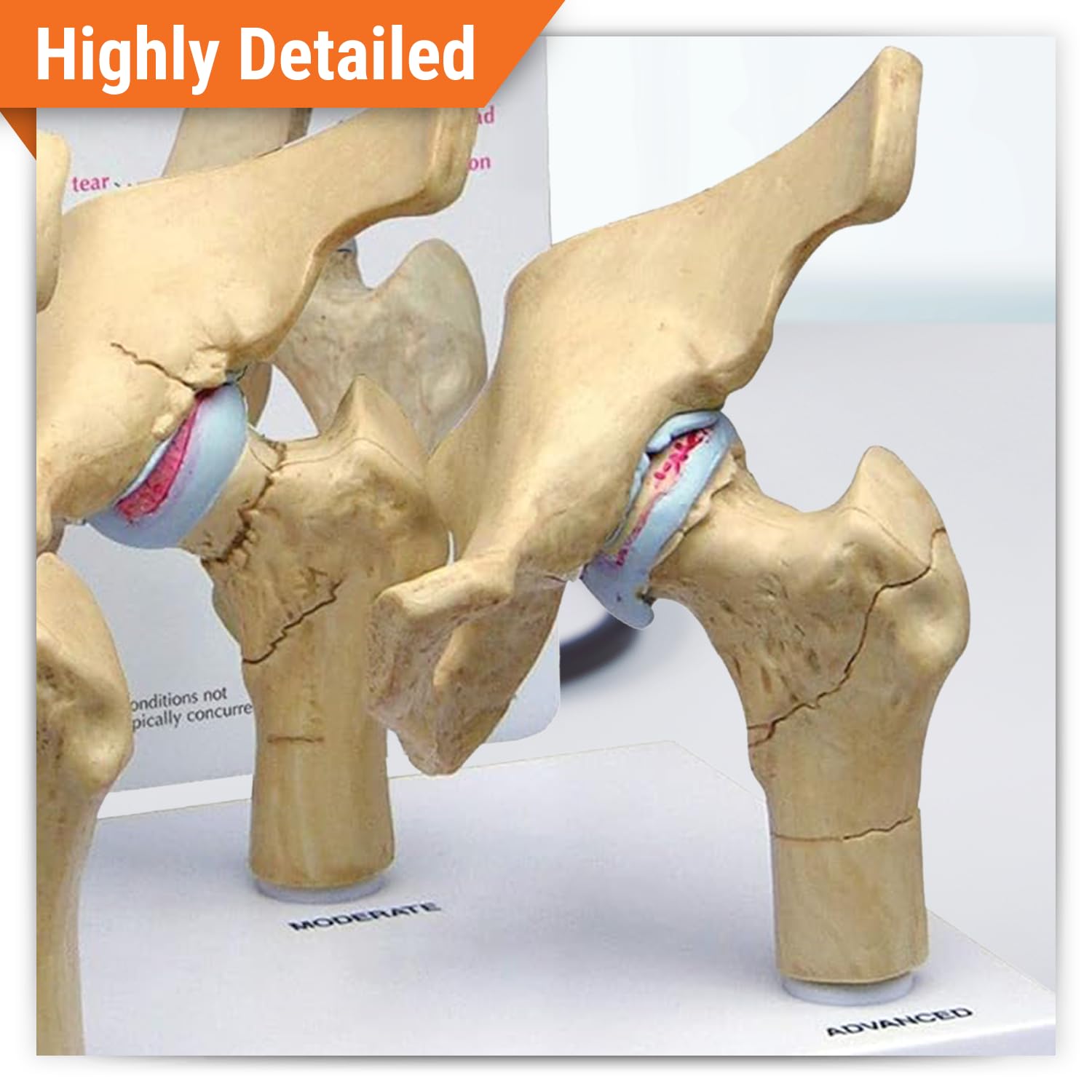 Snapklik.com : 4-Stage Diseased Hip Joint Model Set, Degenerative Bone ...
