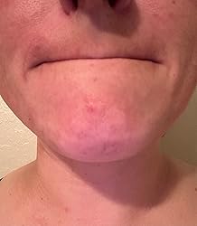 Amazon.com: Dermoscribe - Seborrheic Dermatitis Cream, Eczema Cream ...