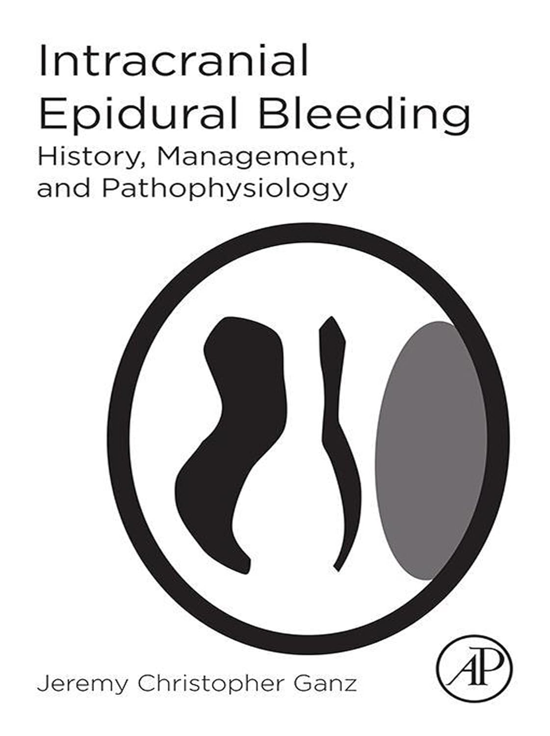 Intracranial Epidural Bleeding: History, Management, and ...