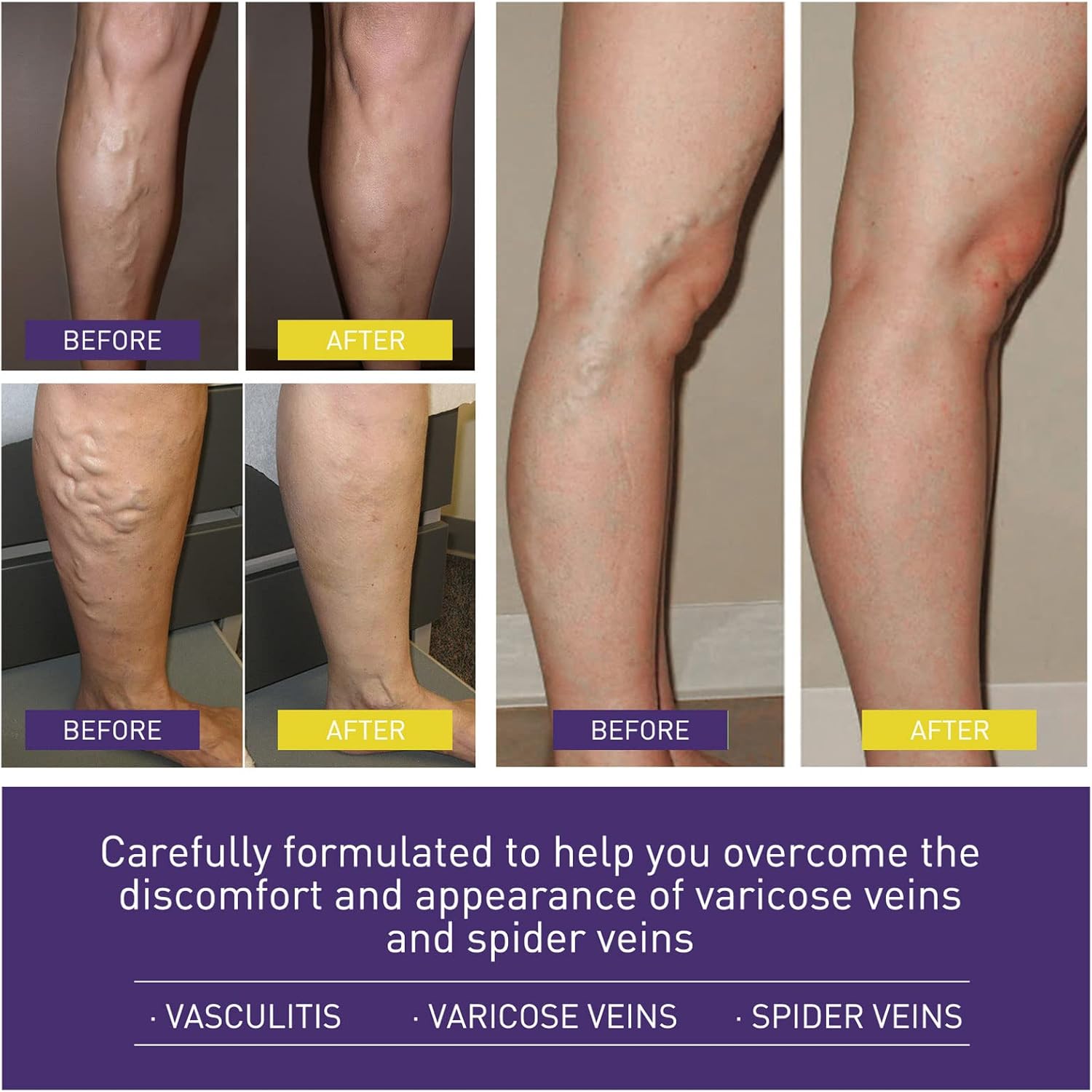 Crema del tratamiento de las venas varicosas de 0.7oz, crema del ...