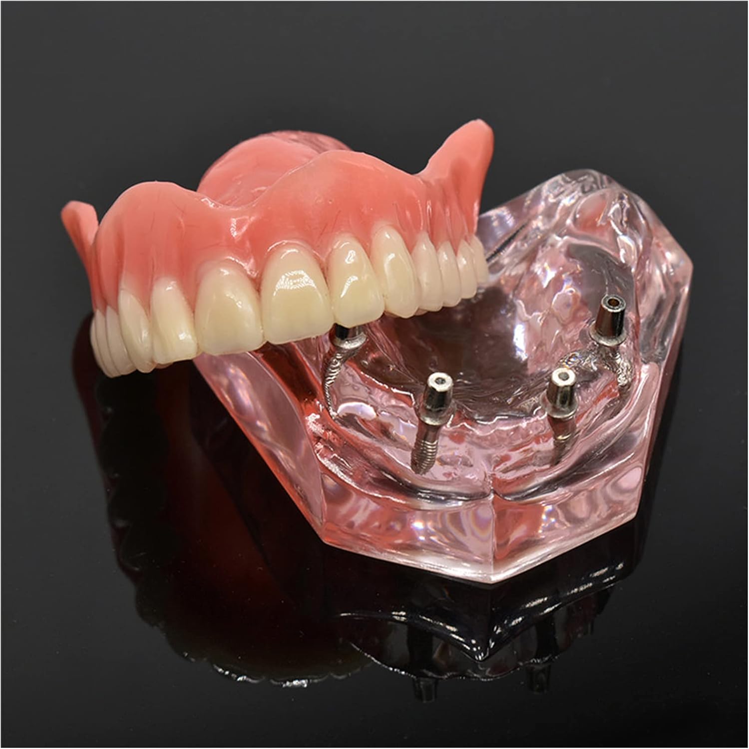 Amazon.com: Dental Typodont Implant Teeth Model Pink Clear Overdenture ...