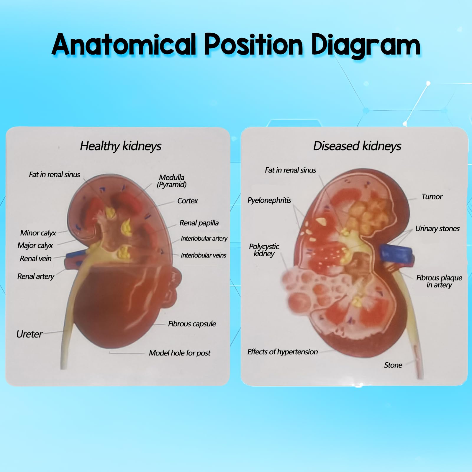 Yanhao Kidney Model For Teaching With 2 Detachable Parts Anatomical ...