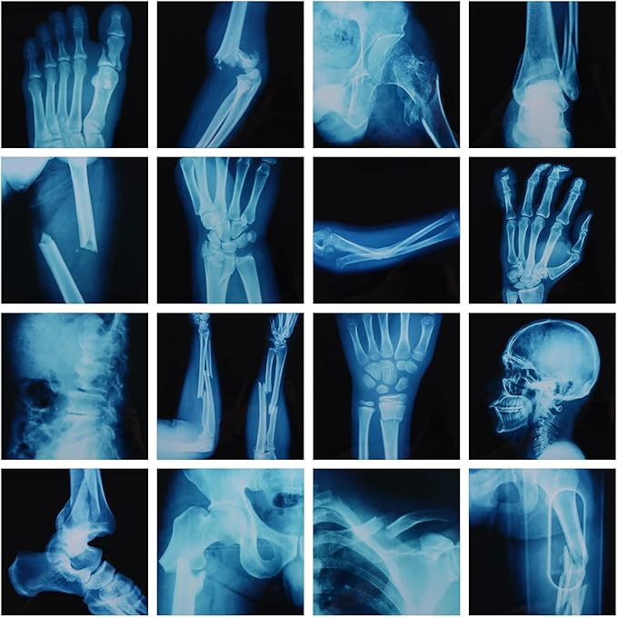 Amazon.com: 16Pcs Realistic Broken Bones X-Ray (9.8"x9.8") Skeleton X ...