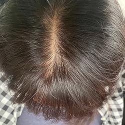 Amazon.com: Capillus Ultra Mobile Laser Therapy Cap for Hair Regrowth ...