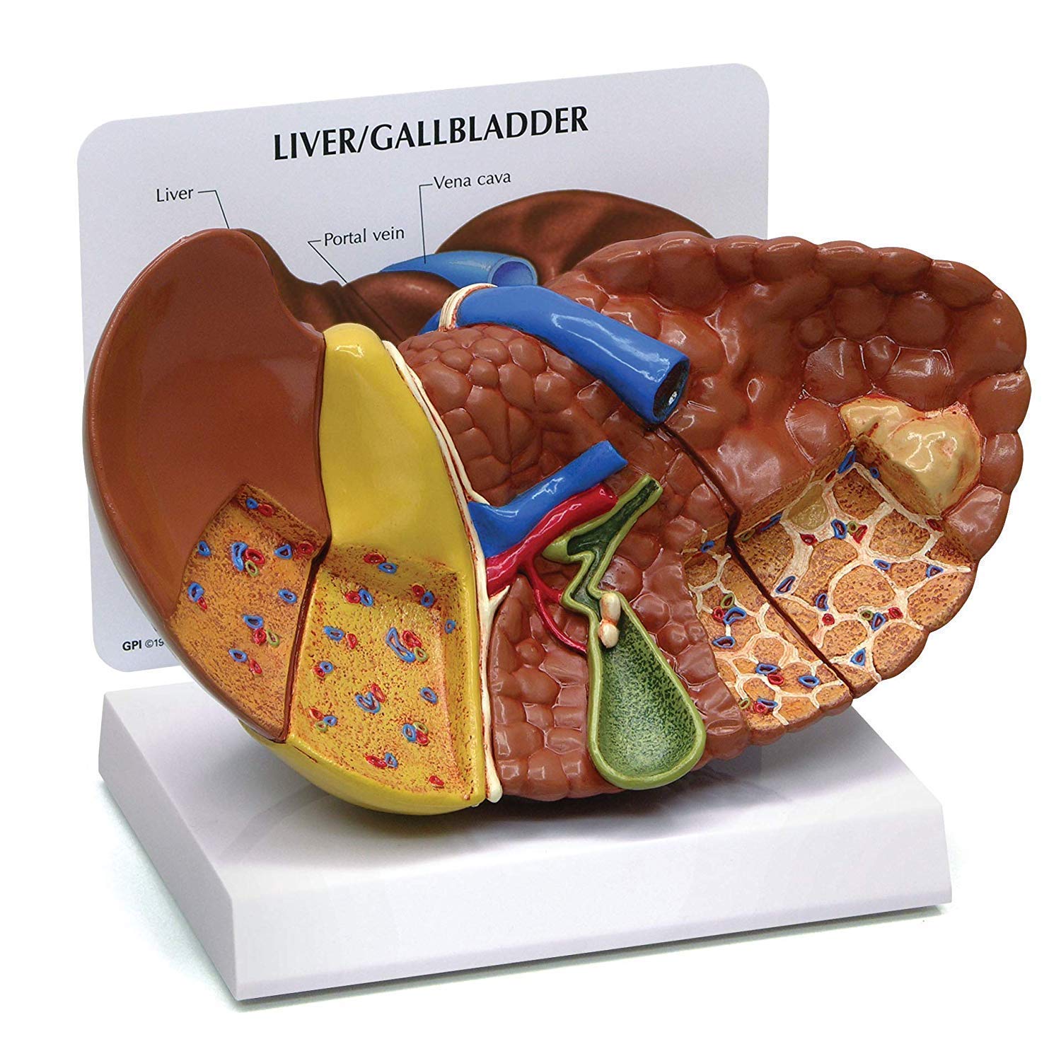 Buy Anatomy Model, Anatomical Model for Art, Human Liver Pathological ...