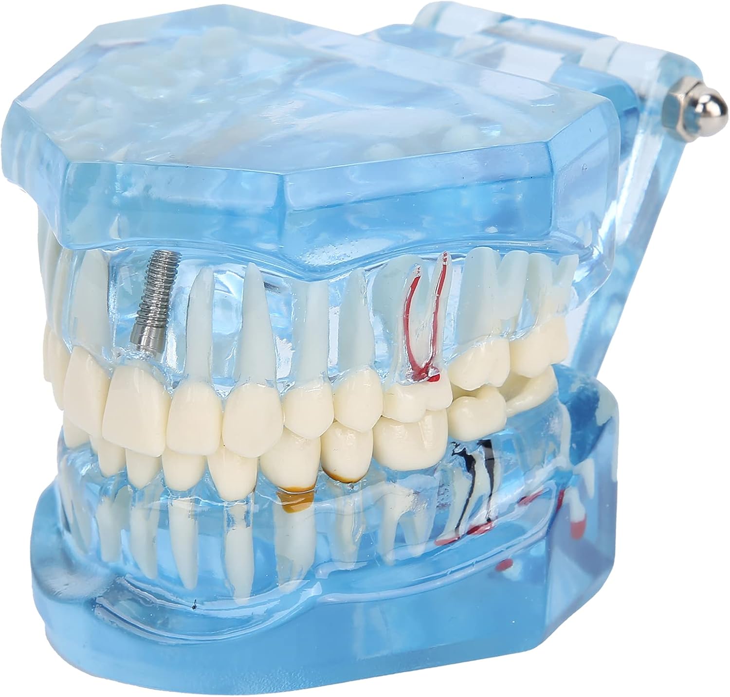 Tooth Model, Removable, Clear, Adult Pathologies, Dental Implant ...
