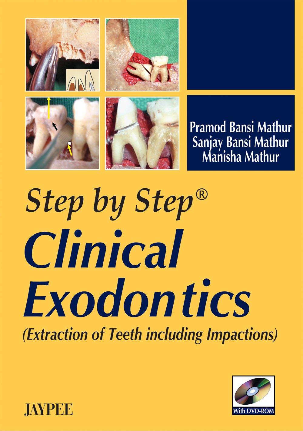Clinical Exodontics: Extraction of Teeth Including Impactions (Step by ...