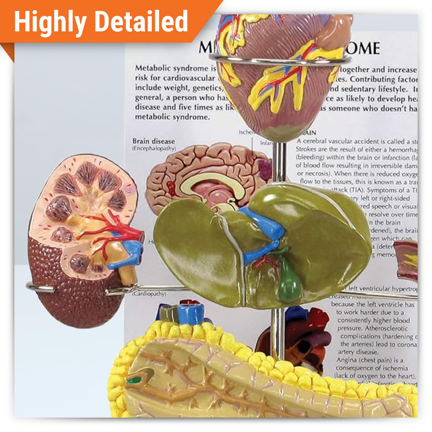 Snapklik.com : Metabolic Syndrome Model Set, Replica For Human Anatomy ...