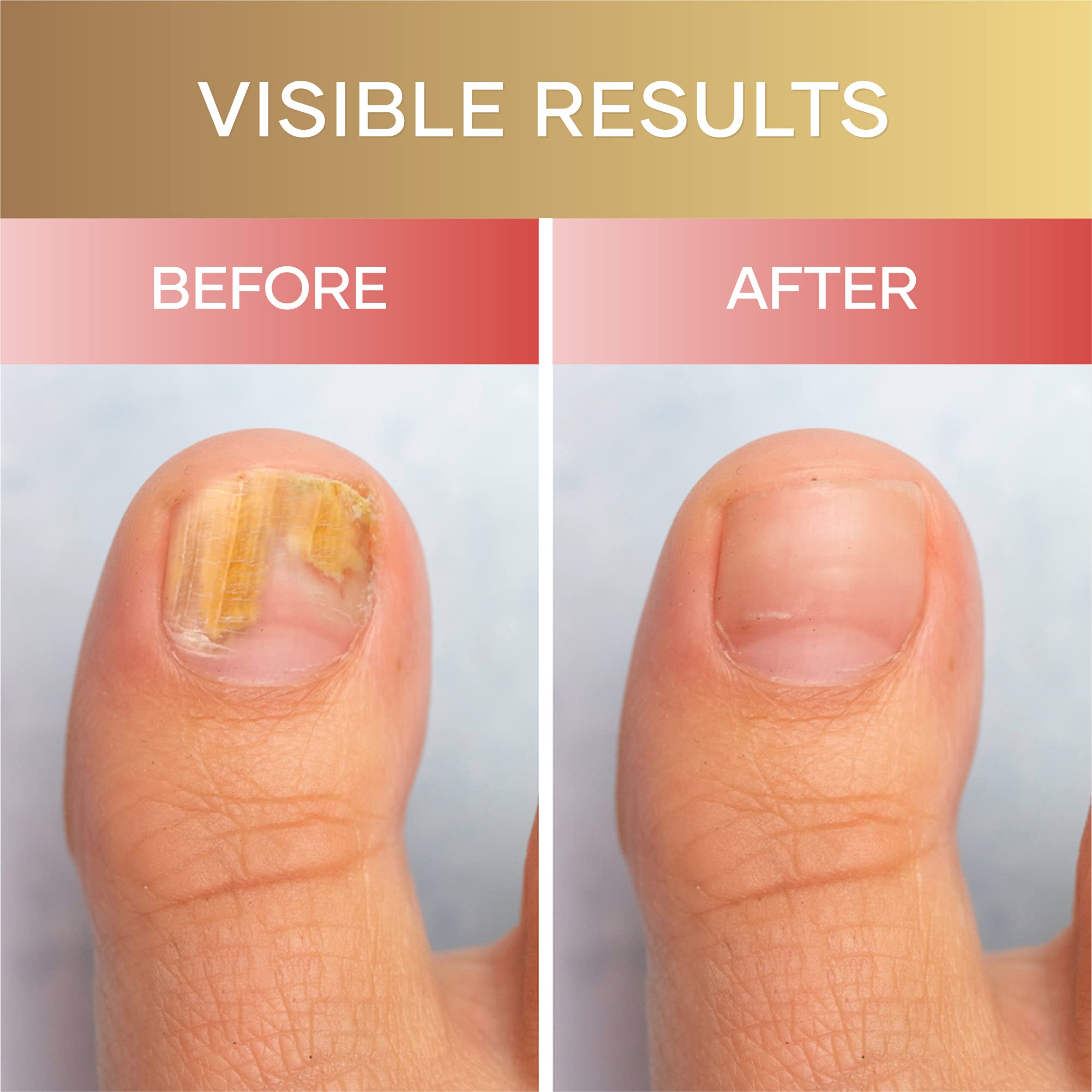 Buy Fungal Nail Treatment | Fast Natural Nail Treatment for Toenails ...