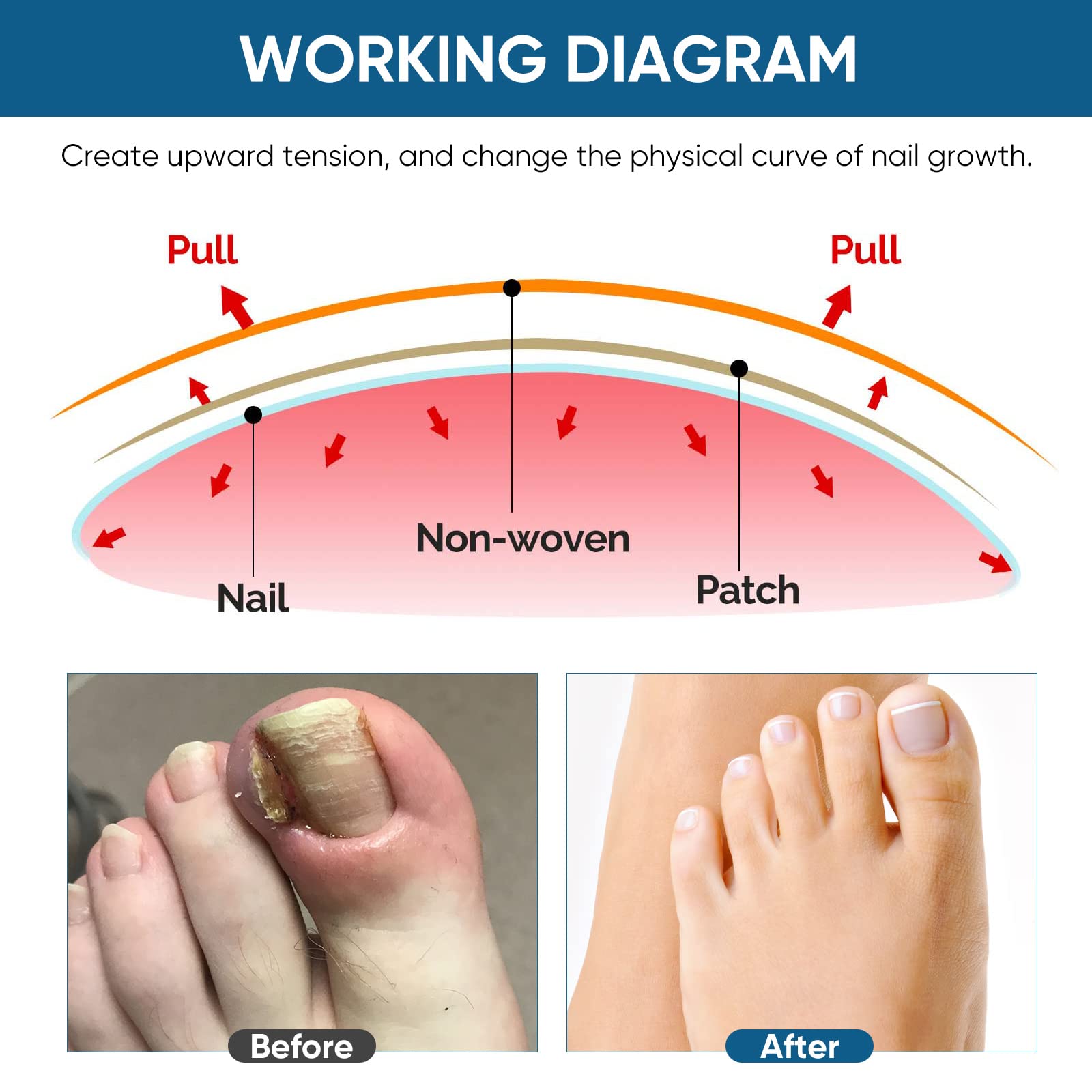 Ingrown Toenail Diagram