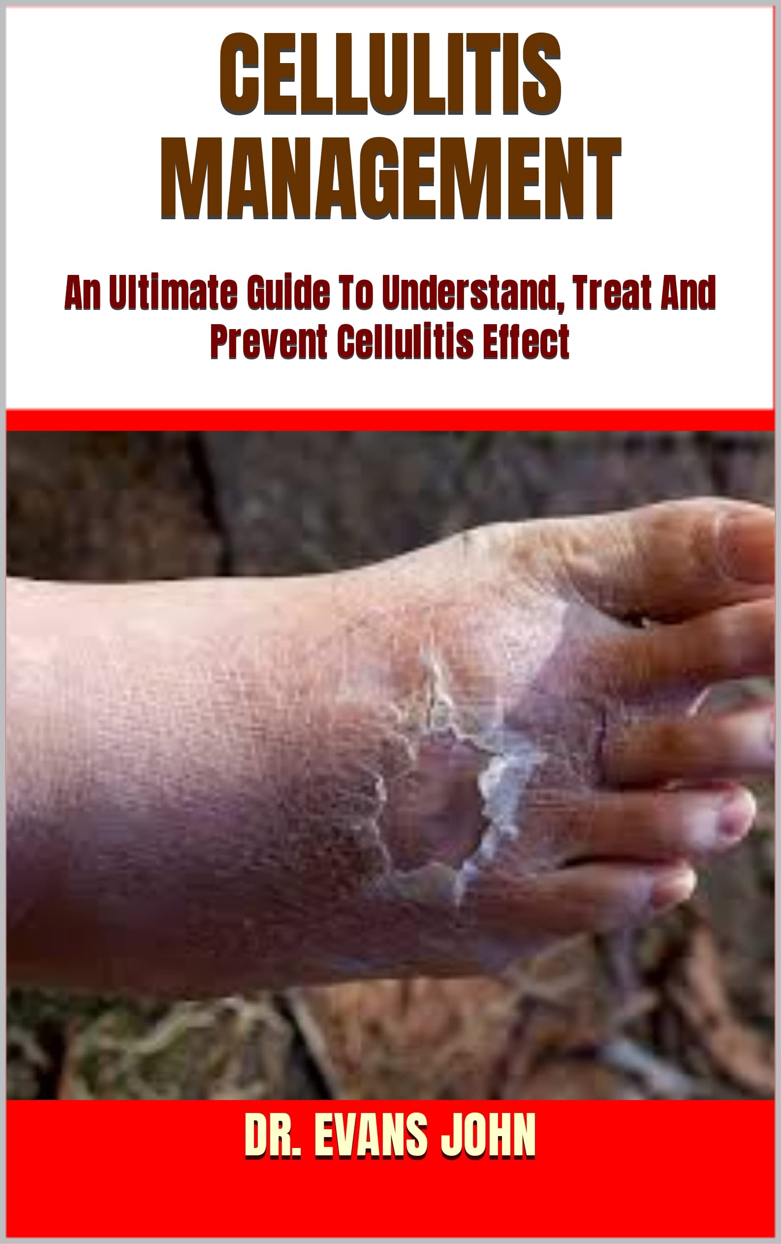 Buy CELLULITIS MANAGEMENT : An Ultimate Guide To Understand, Treat And ...