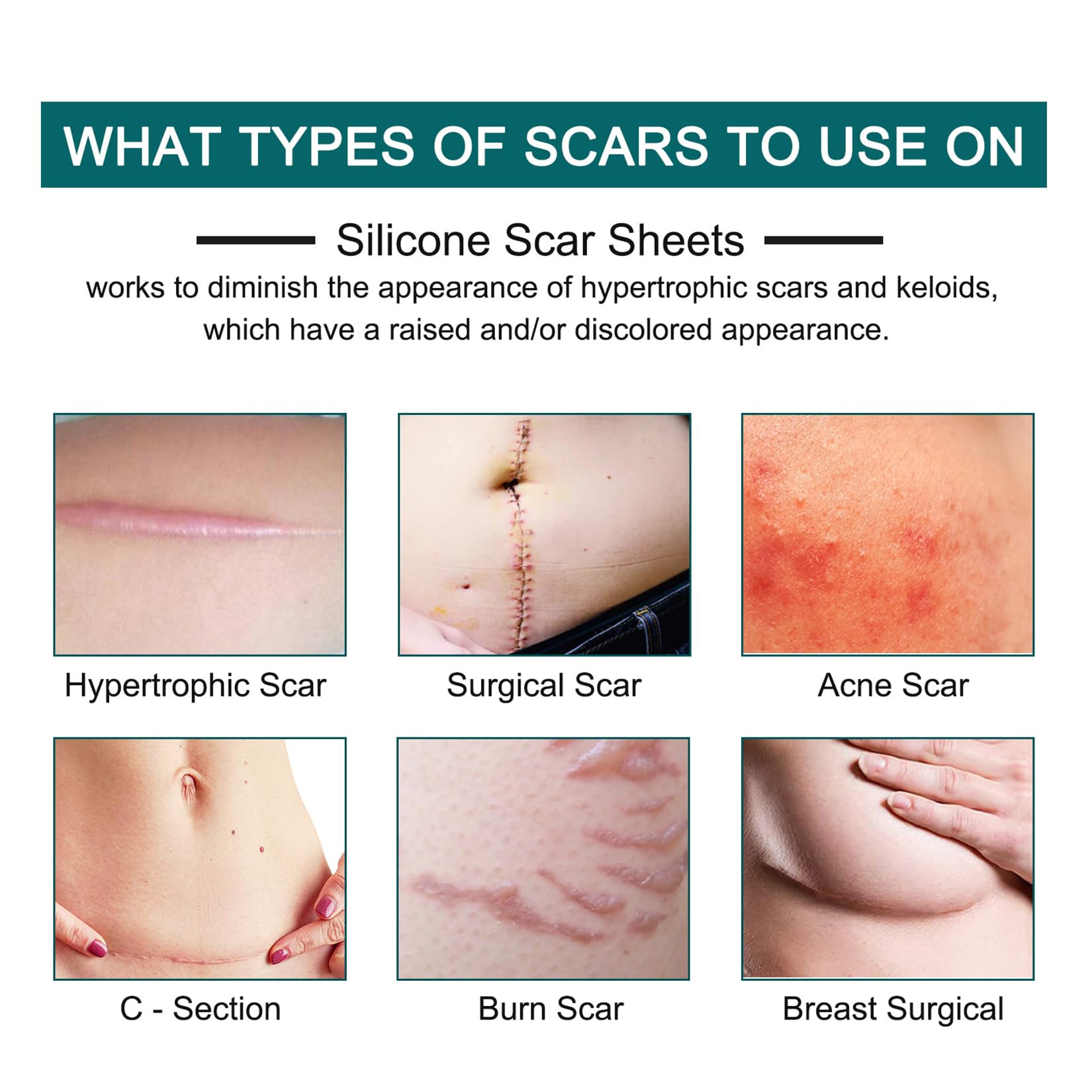 Snapklik.com : Silicone Scar Tape, Silicone Scar Sheets, Scar Silicone ...