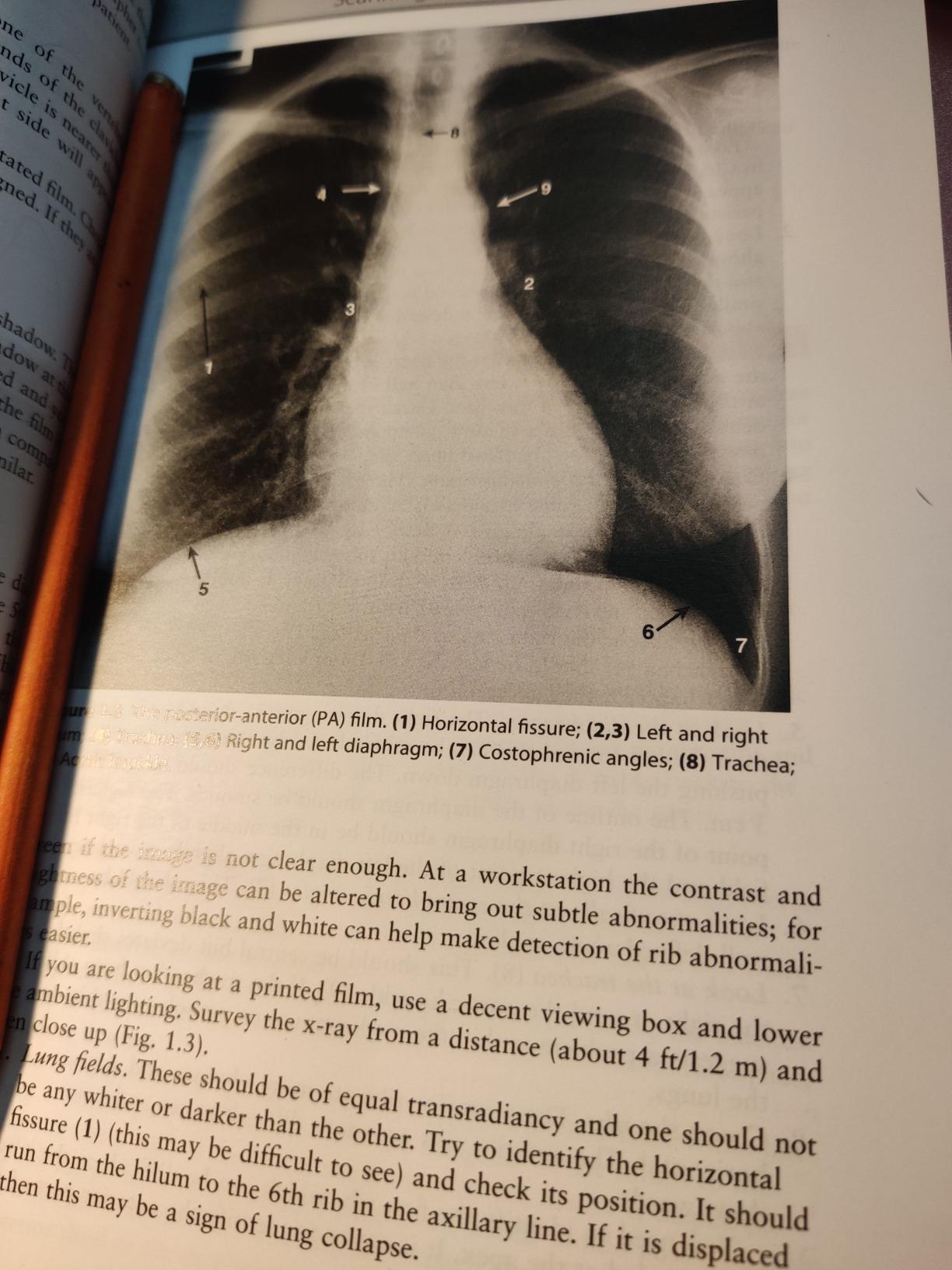 Buy Chest X-Ray Made Easy, International Edition Book Online at Low ...