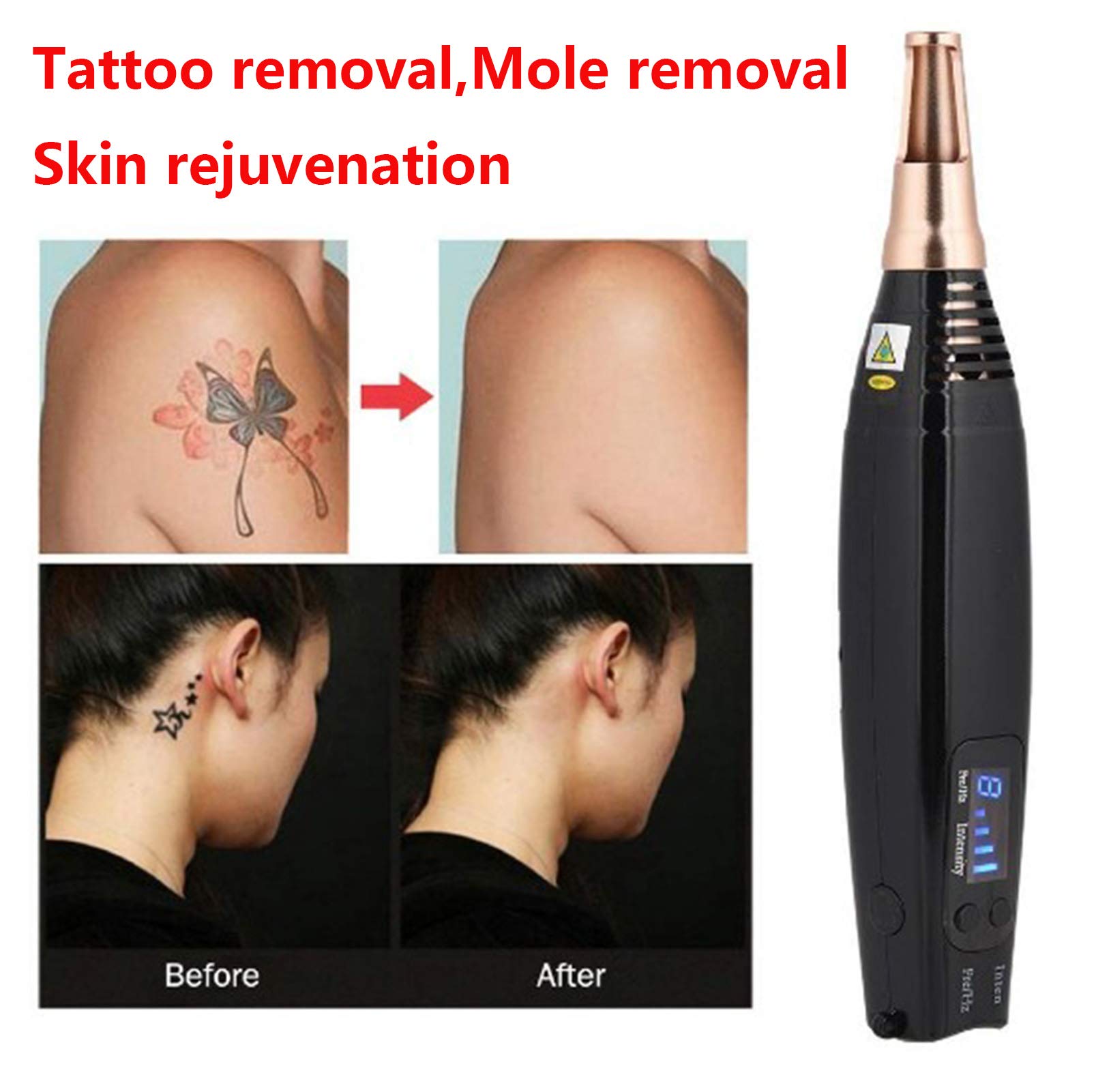 Molaire Tattoos TattooClear Tattoos Verwijderen, Pigmentvlekken,