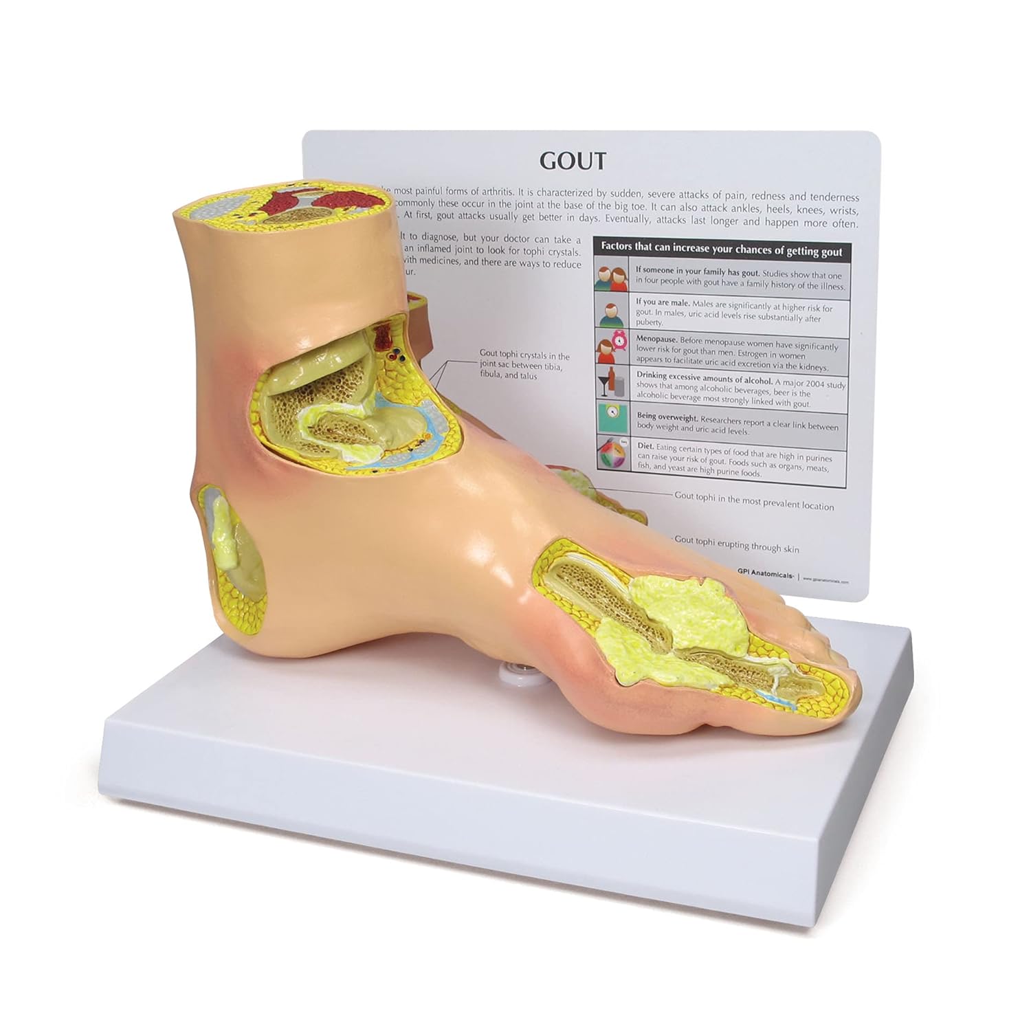 GPI Anatomicals - Left Foot Model with Gout, Replica for Human Anatomy ...