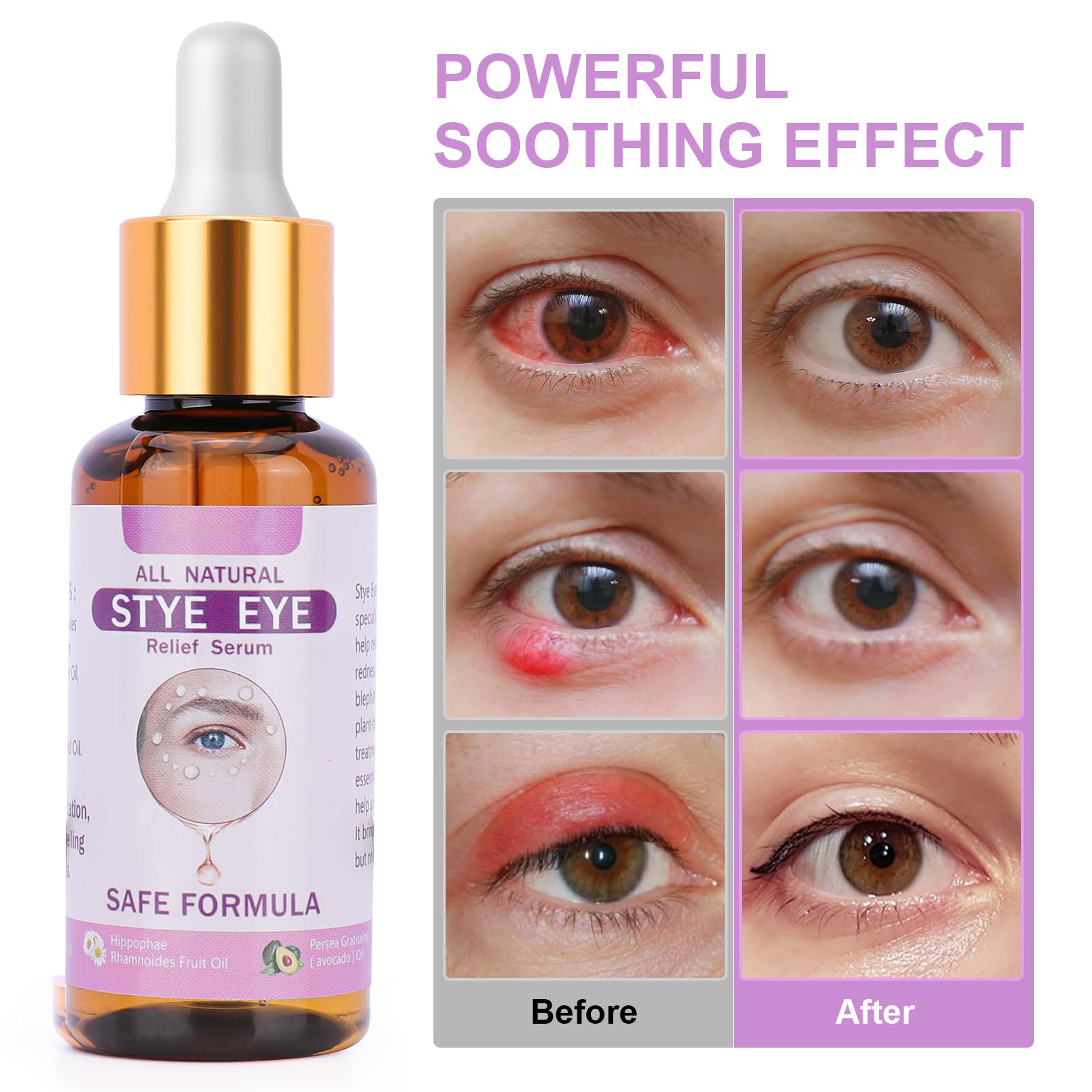 Snapklik.com : Stye Eye Treatment, Chalazion Remover For Eye Stye, Stye ...