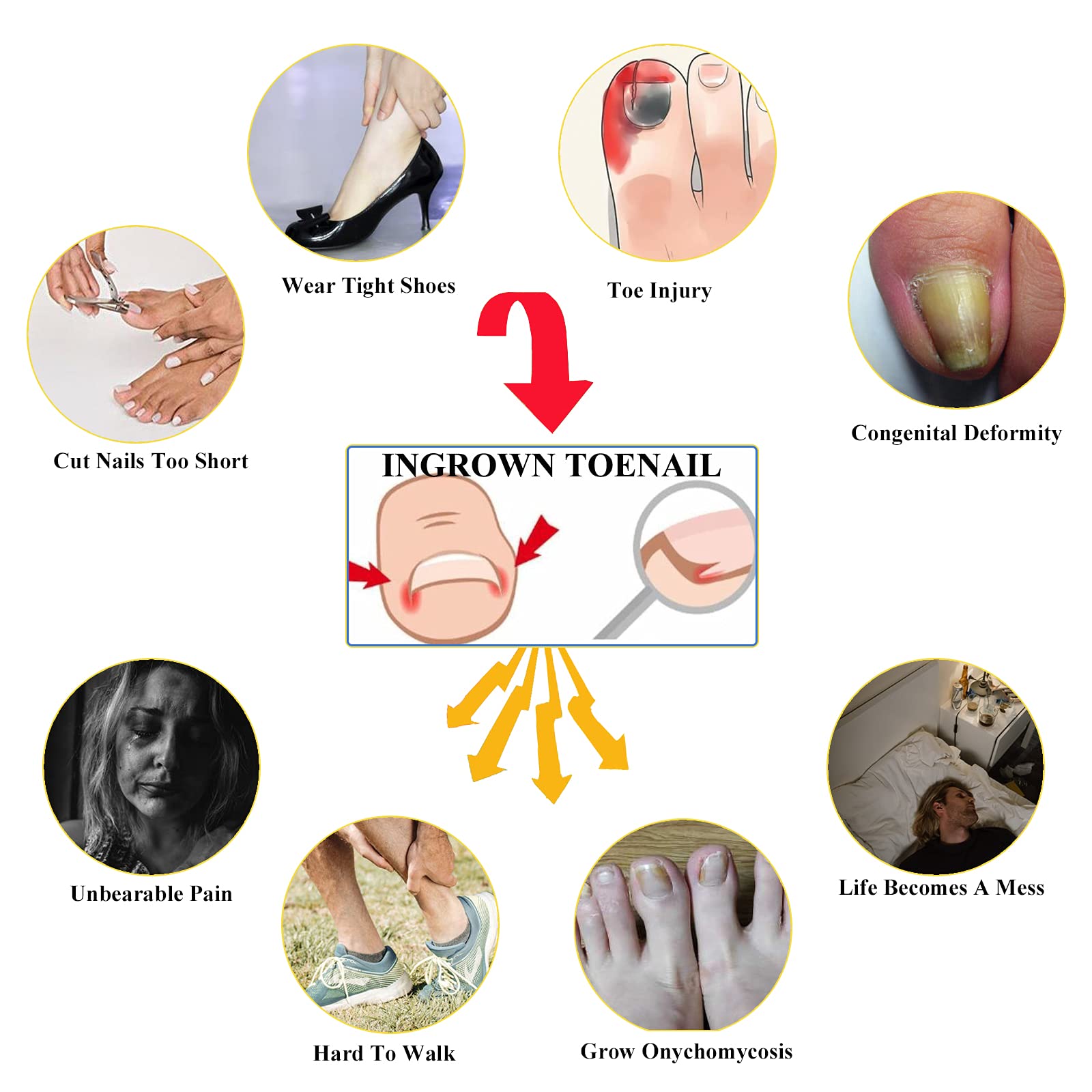 Ingrown Toenail Treatment Kit, Ingrown Toenail Corrector Stainless ...