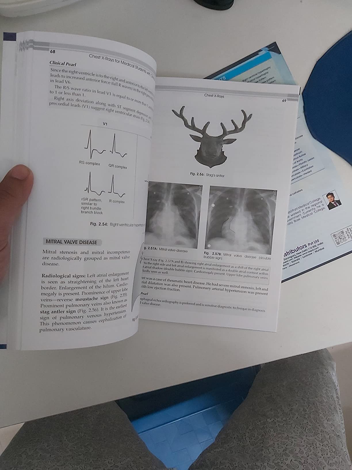 Chest X-ray for Medical Students with Clinical Tutorials eBook ...