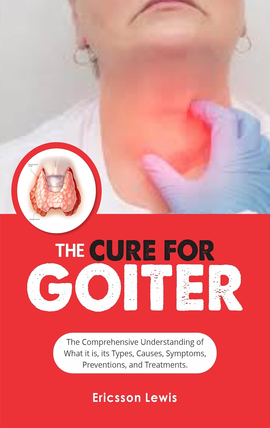 THE CURE FOR GOITER: The Comprehensive Understanding of What it is, it ...