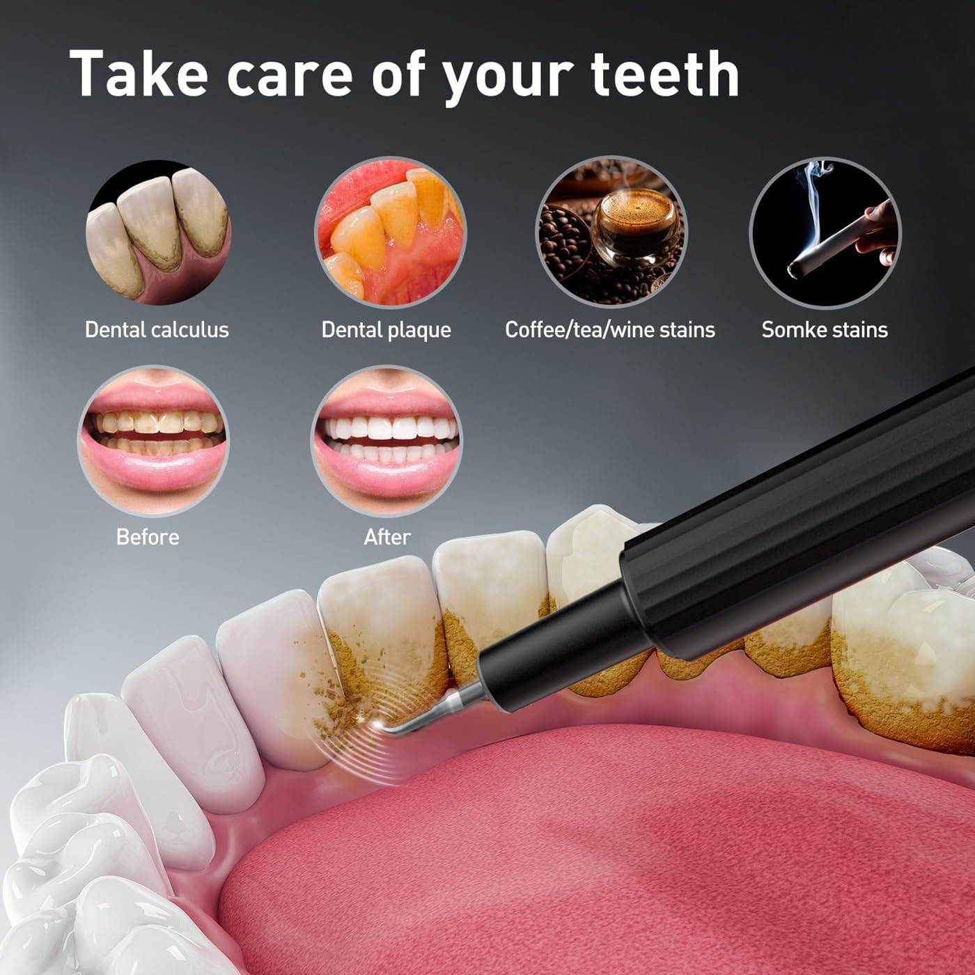 Plaque Remover for Teeth – Tartar Remover for Teeth, Dental Calculus ...