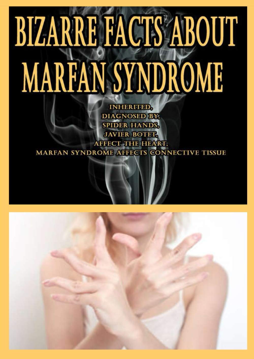 Buy Bizarre Facts About Marfan Syndrome: Inherited, Diagnosed By ...