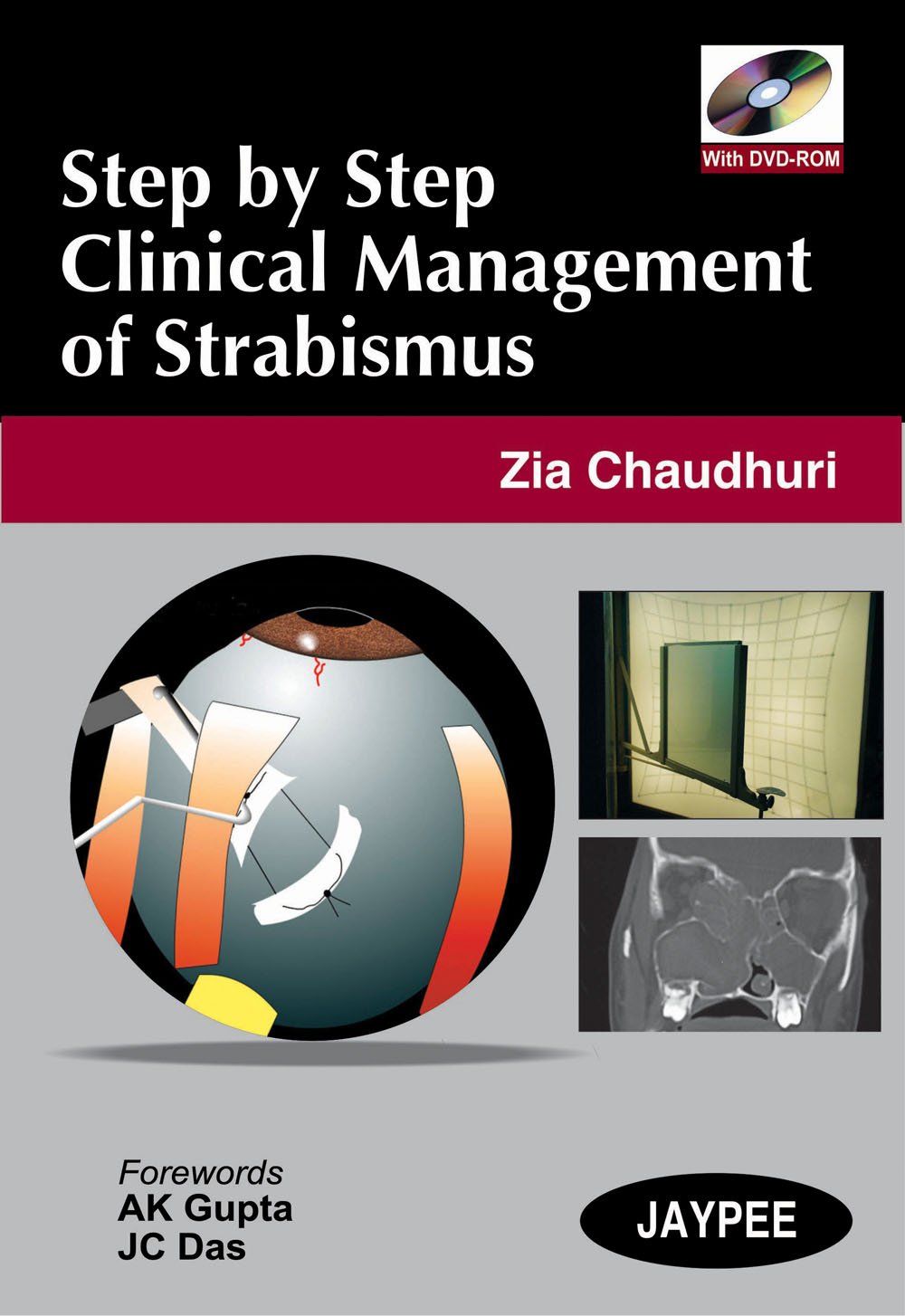 Step by Step Clinical Management of Strabismus: 9788184482331: Medicine ...