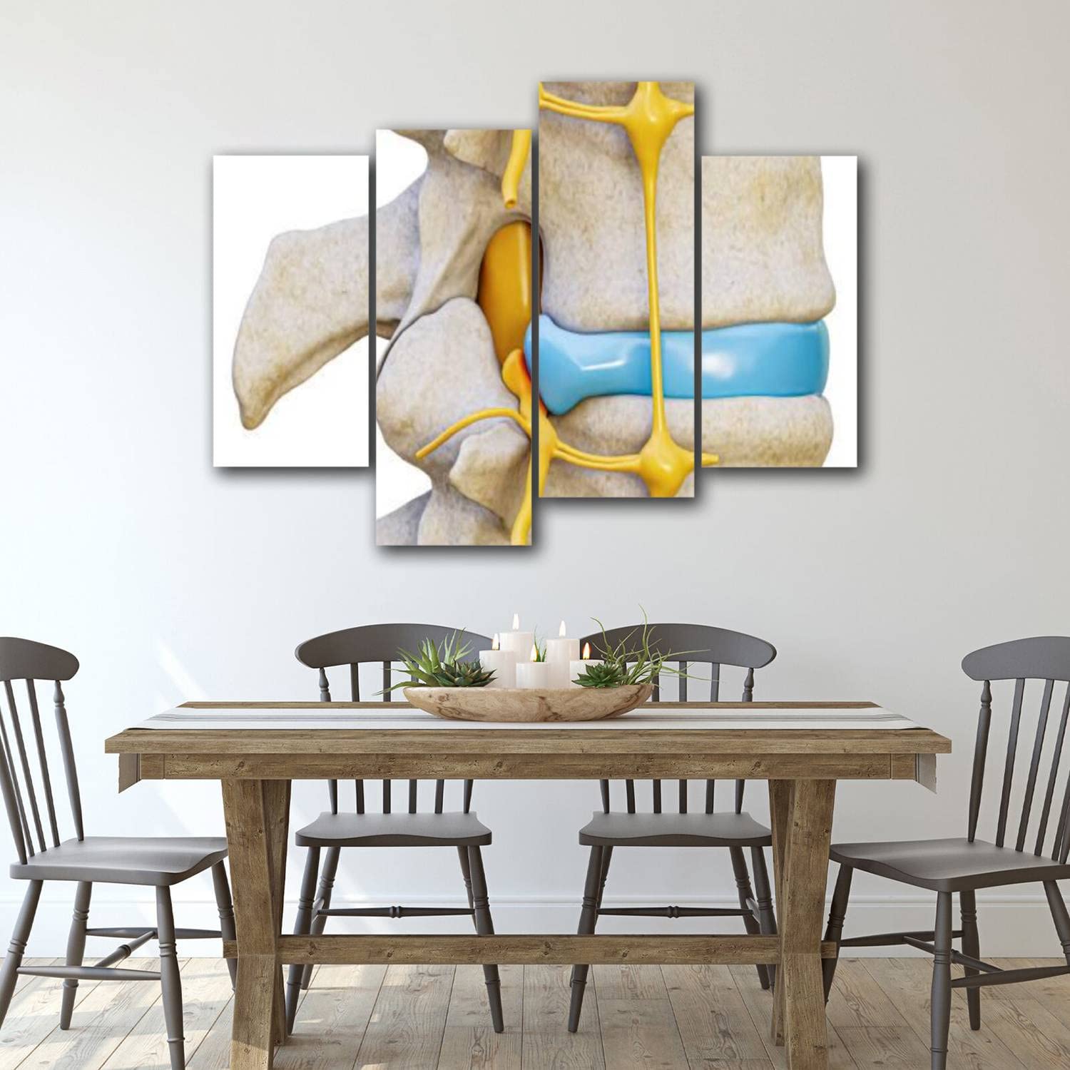 Snapklik.com : Orthopedic Human Anatomy Medical Poster Herniated Spinal ...