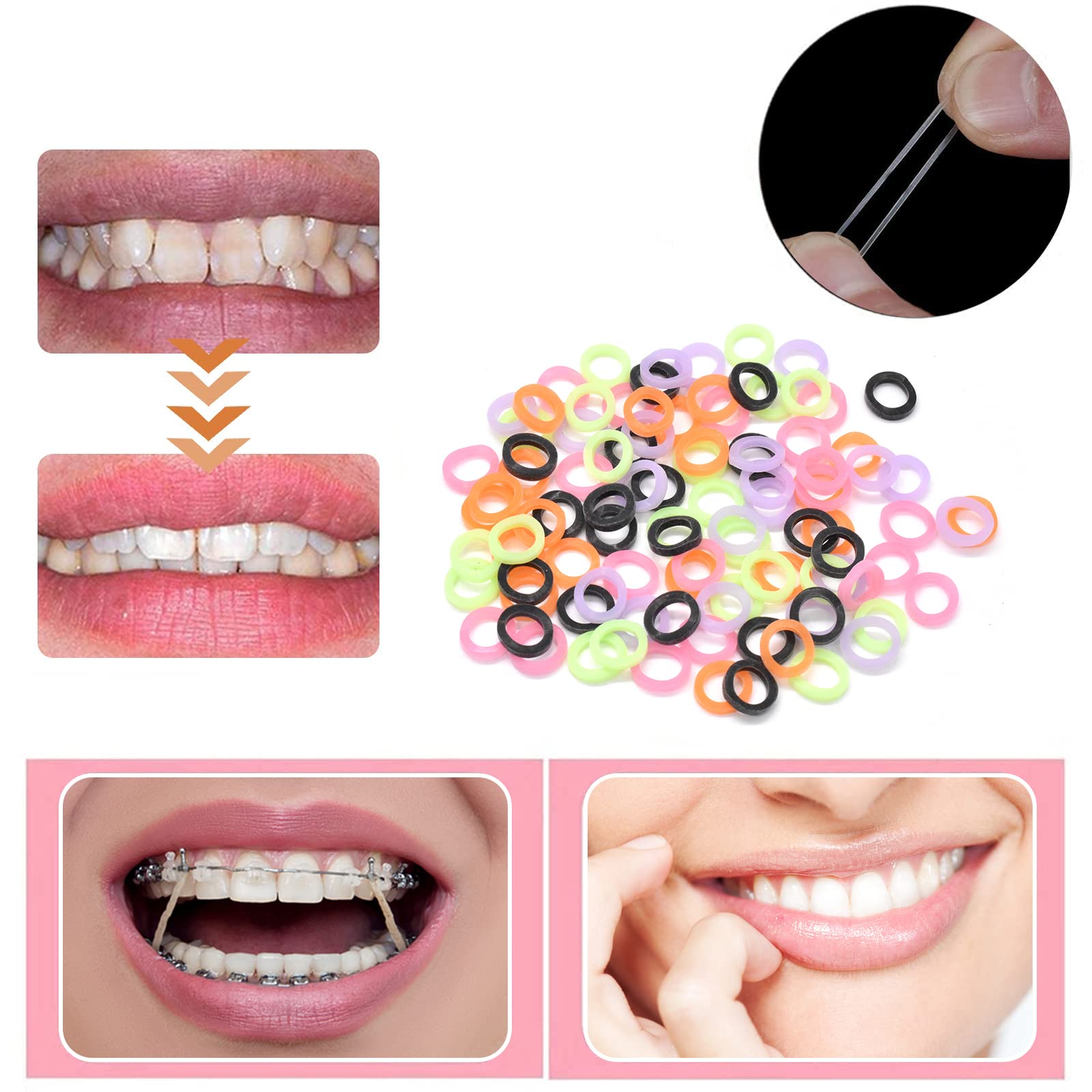 Braces Rubber Bands Different Colors Metal Braces | Braces Auburn